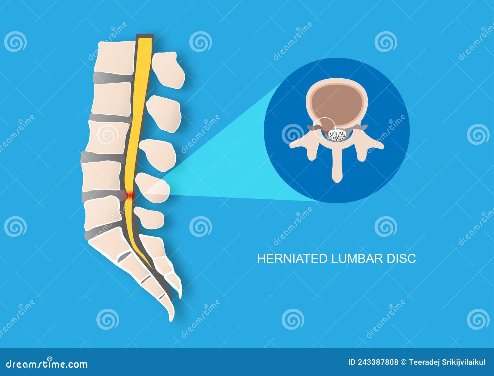 Herniated Lumbar Vertebral Disc Vector Illustration Stock Vector