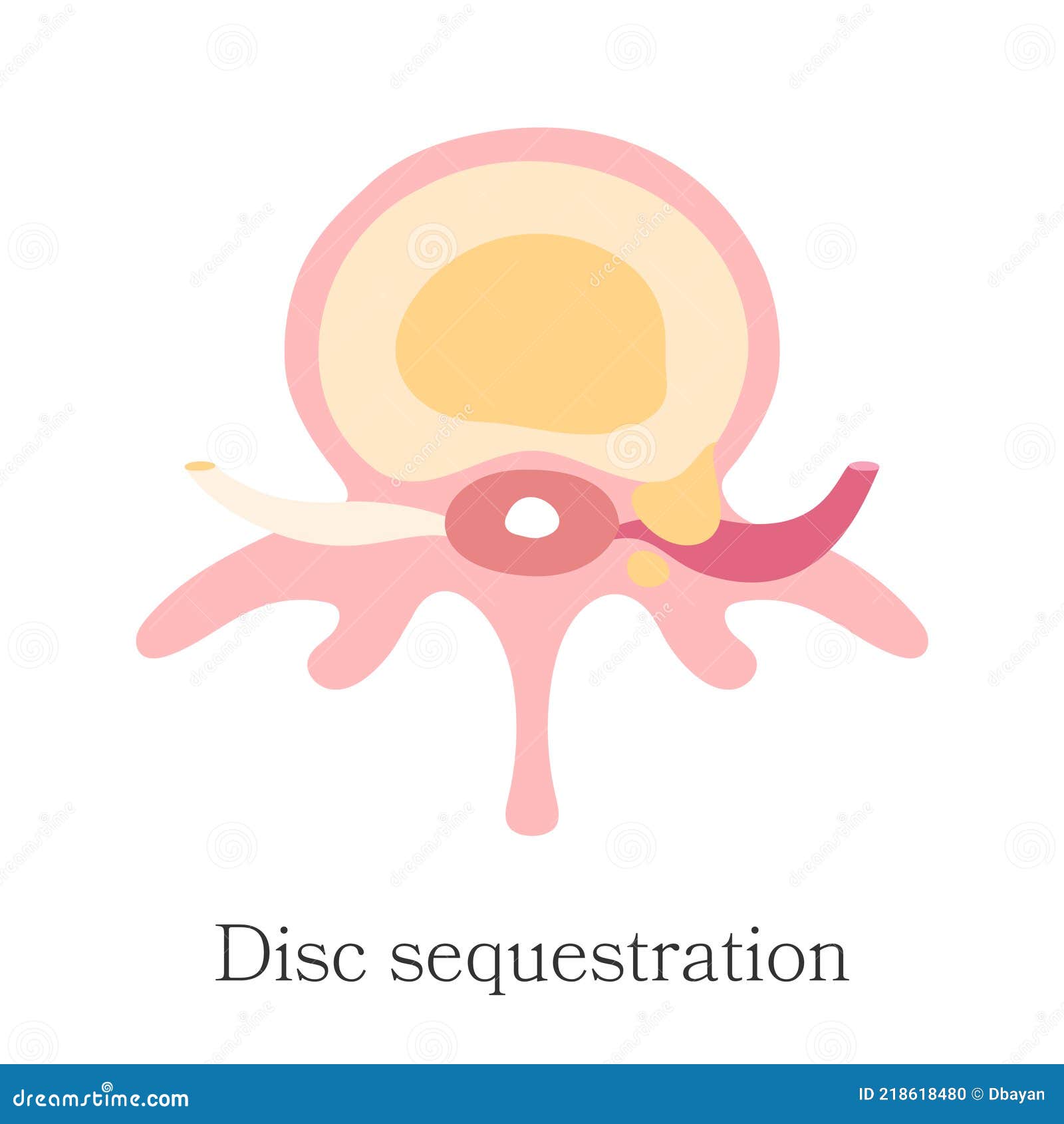 Herniated Spinal, Stage Fourth, Sequestration and Compression Nerve ...