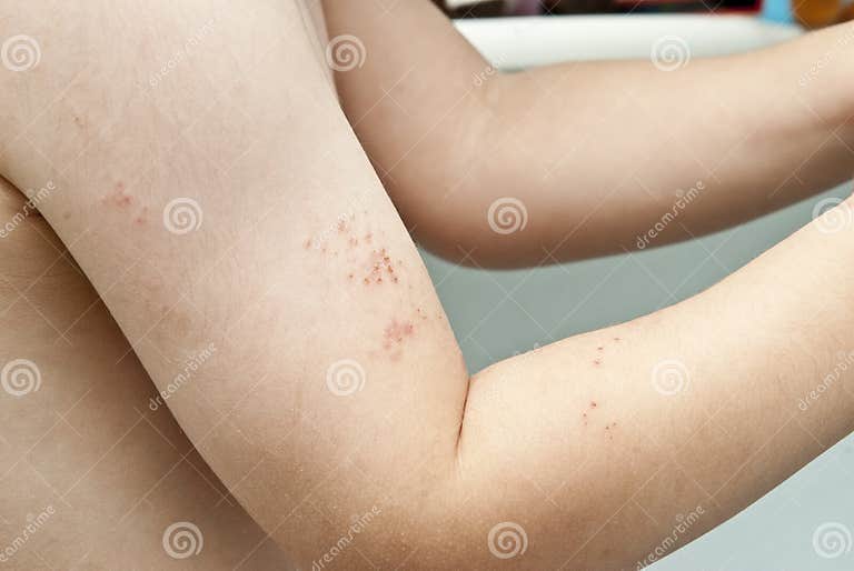 Herpes in a child arm. stock image. Image of body, pimples - 24336479