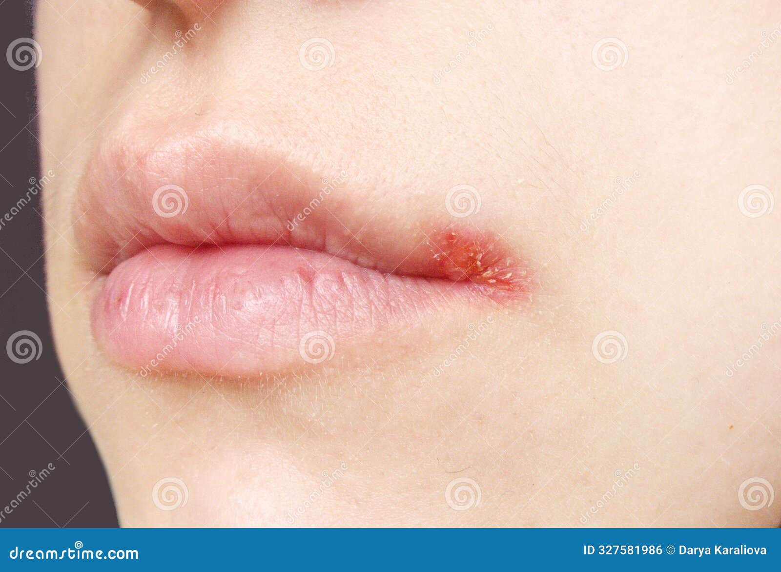 Herpes in the Corner of the Lips Stock Photo - Image of inflamed ...