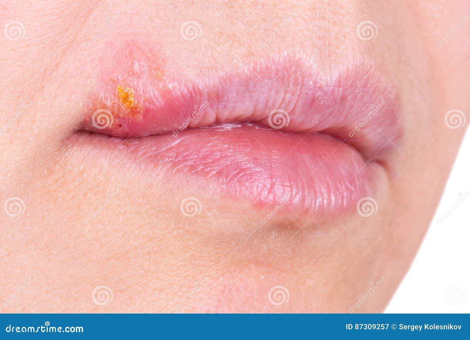 Herpes On The Lip Close-up Macro. Woman Lubricates The Labial Herpes ...