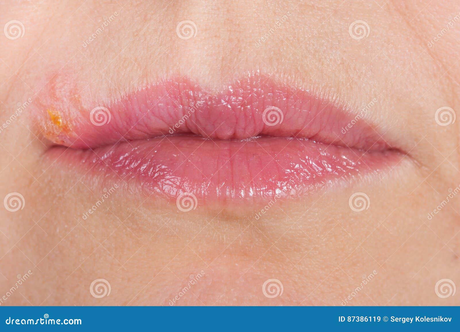 Herpes on the Lip Close Up Macro Stock Image - Image of disgusting ...