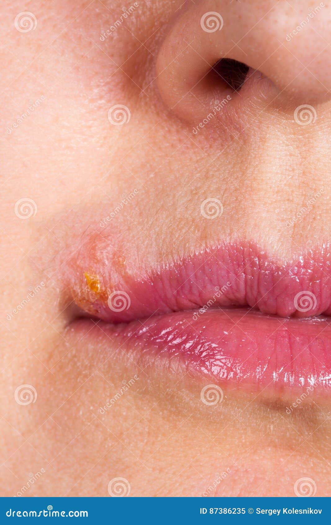 Bump On Upper Lip