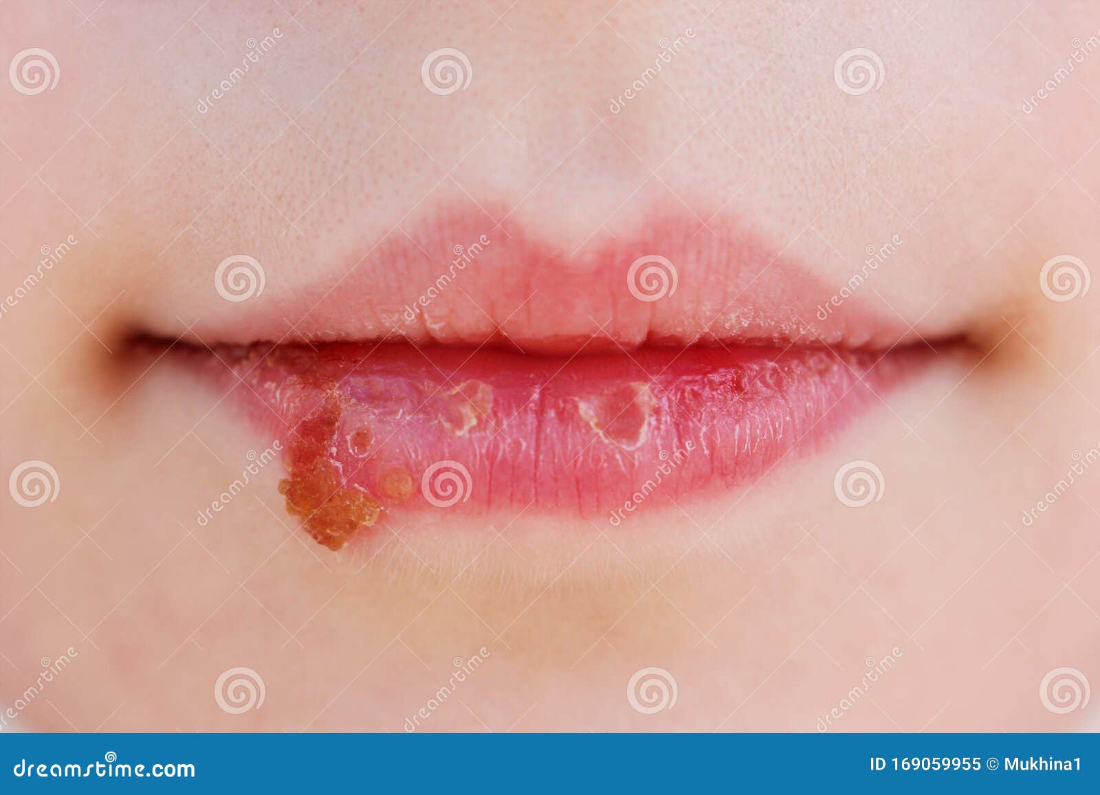 Herpes on Lips of Child. Treatment Ointment Stock Image - Image of cold ...