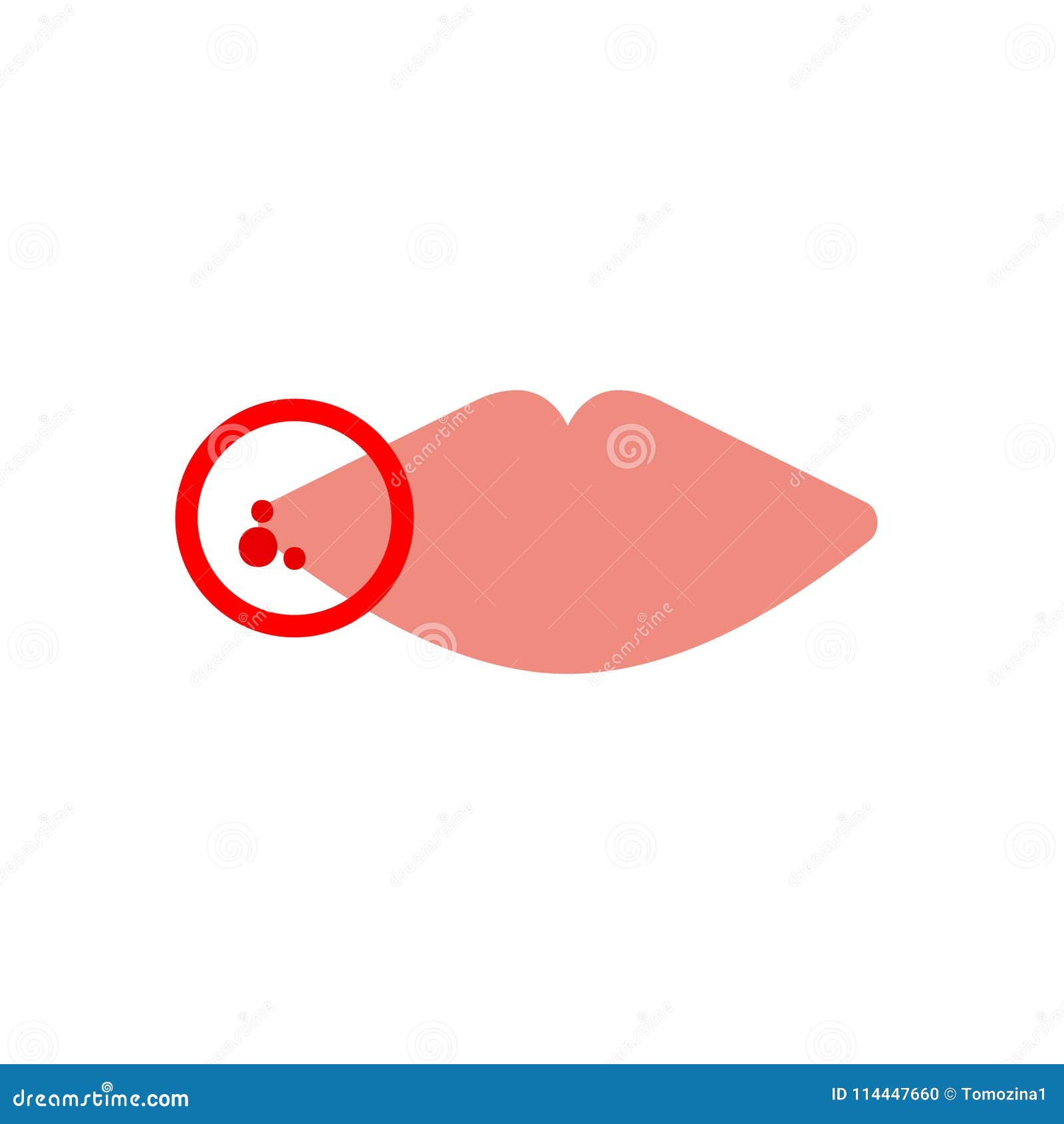 Herpes HSV Cold Sore Lip Outbreak Medical Icon Vector Illustration ...