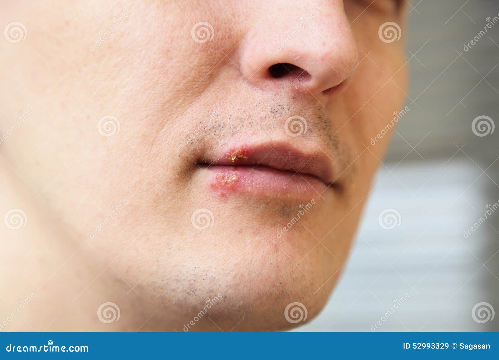 Herpes In Lips Is A Viral Skin Disease Stock Photography ...