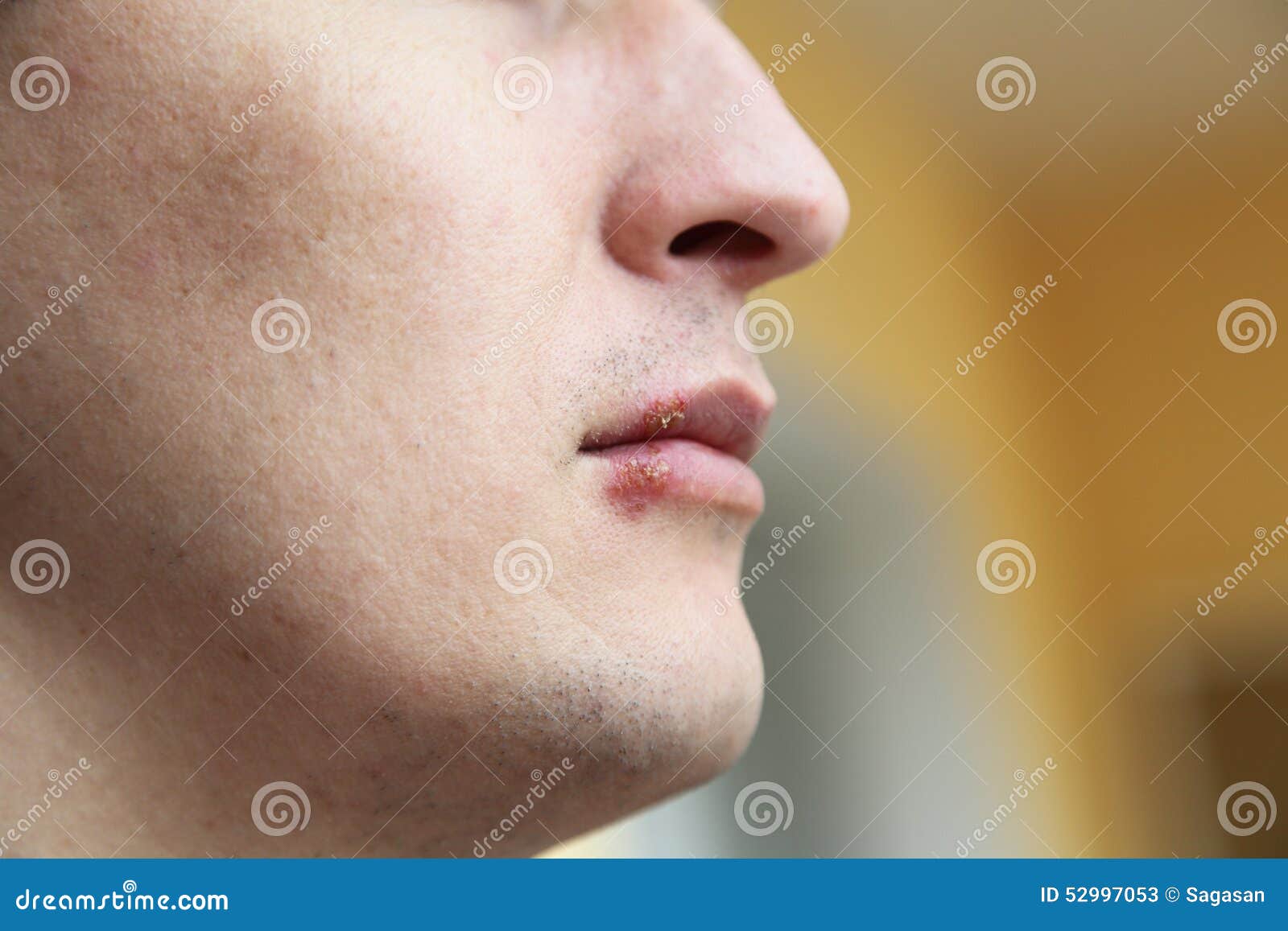 Herpes on the lips stock image. Image of medical, frame - 52997053