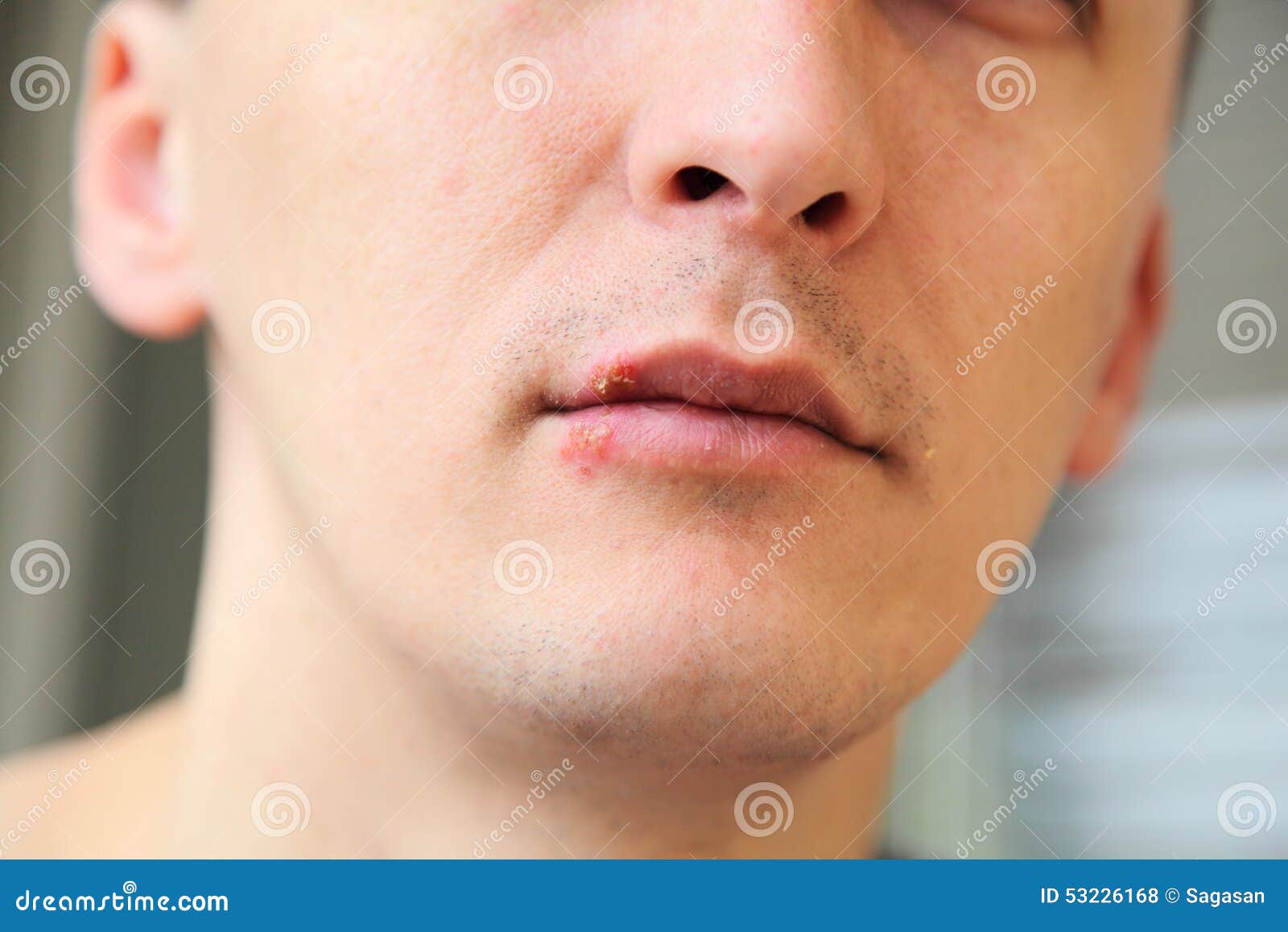 Herpes on the lips stock photo. Image of lips, cold, injury - 53226168