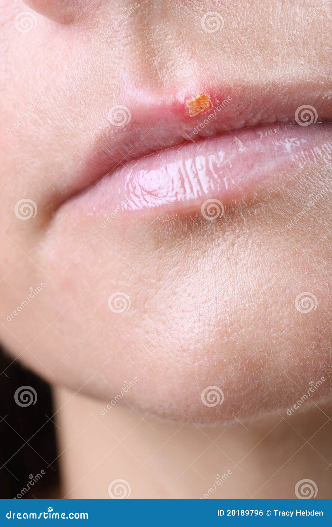 Herpes simplex virus stock photo. Image of infection - 20189796 Herpes simplex virus stock photo. Image of infection - 20189796