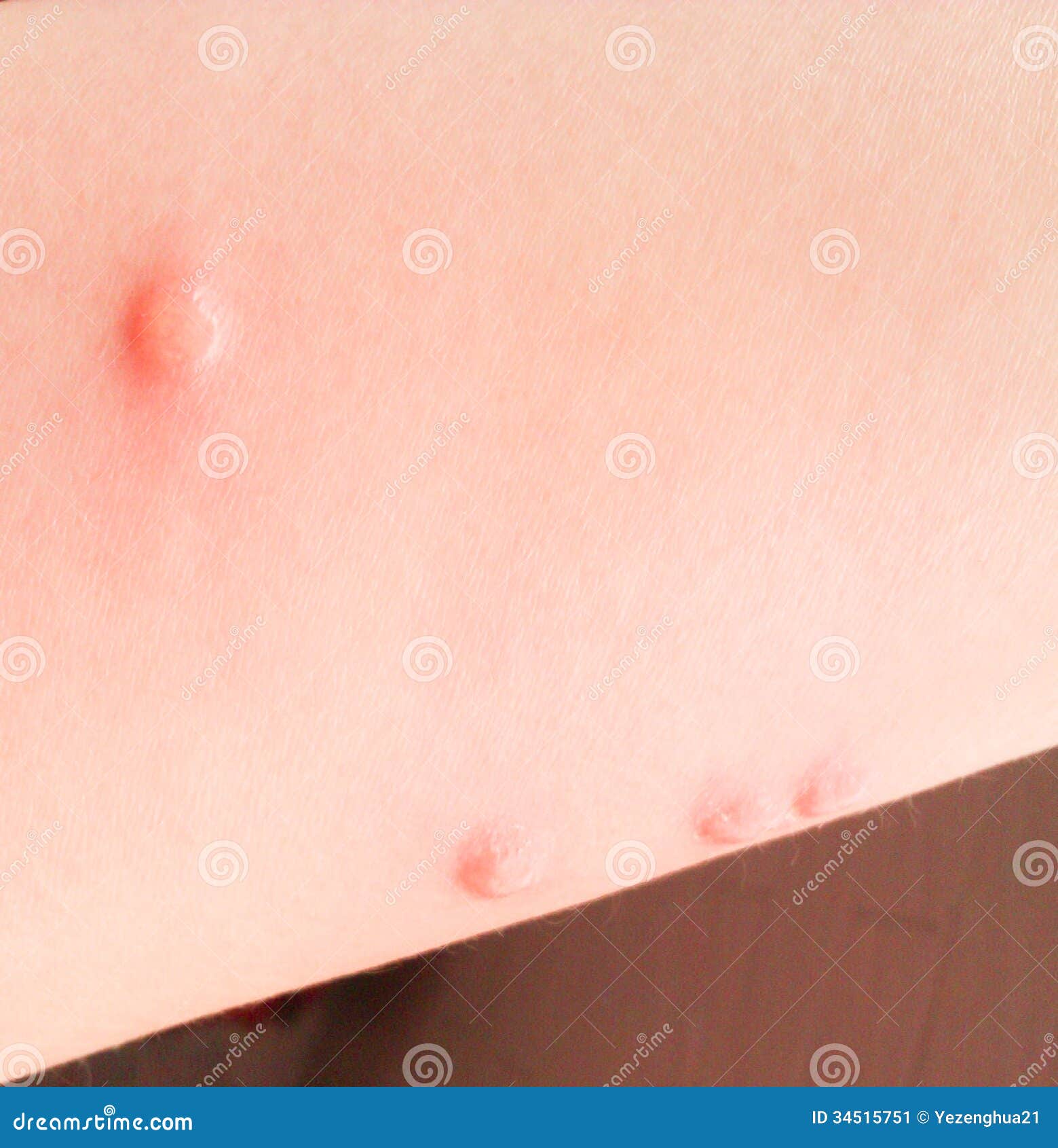 Herpes stock image. Image of treatment, closeup, skin - 34515751