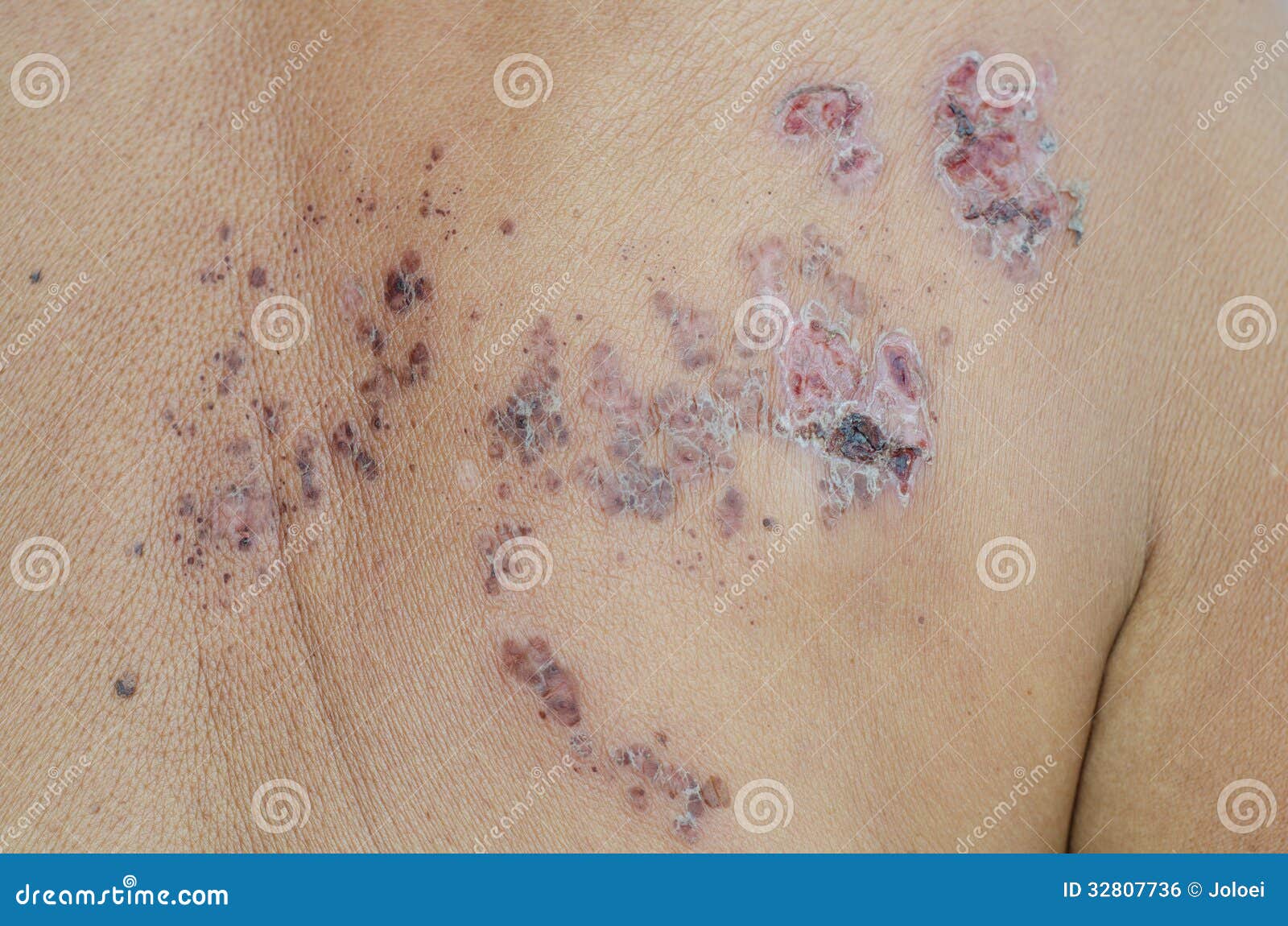 Hives Red Welts Stock Photos - Free & Royalty-Free Stock Photos from ...