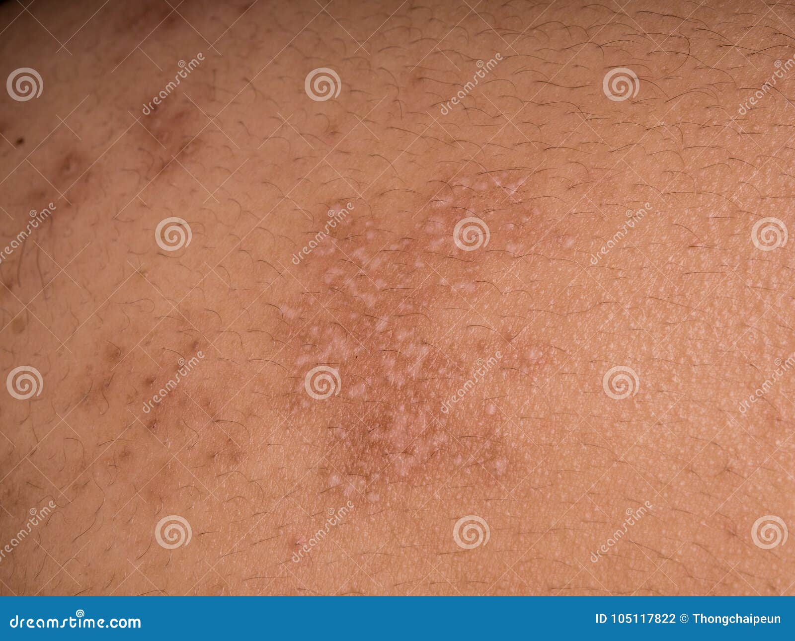 Raised Scar. Scar After Appendectomy. Cyanotic Keloid Scar Caused By ...