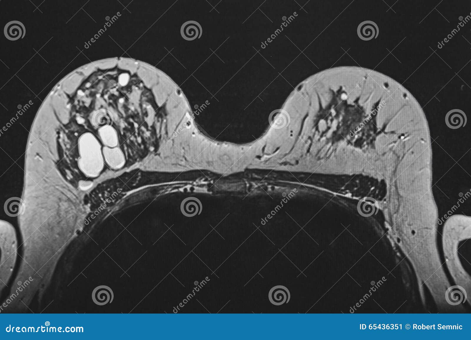 HERRmammography, cystor fotografering för bildbyråer. Bild av stängning ...