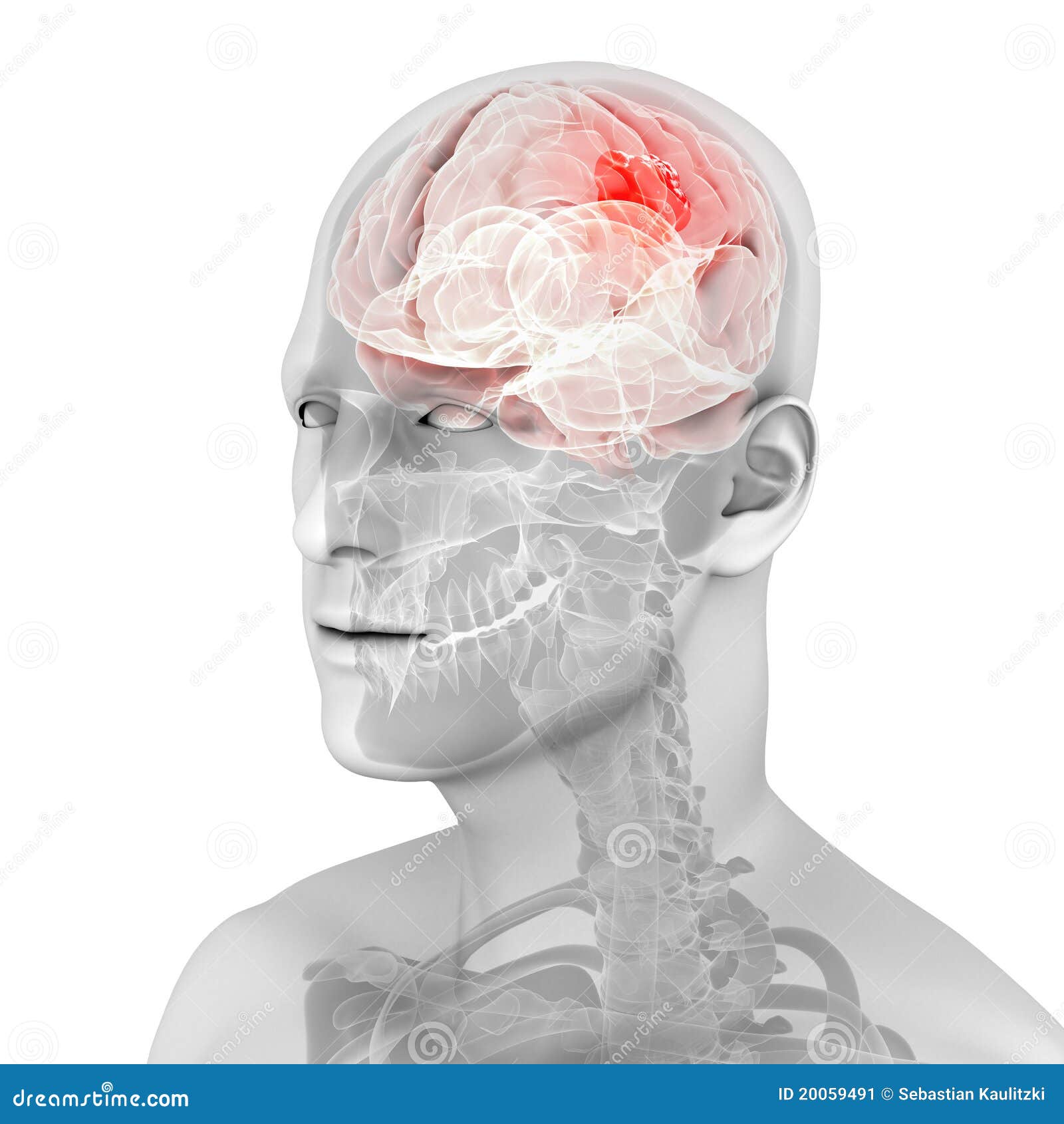 Hersen tumor stock illustratie. Illustration of hersenen - 20059491