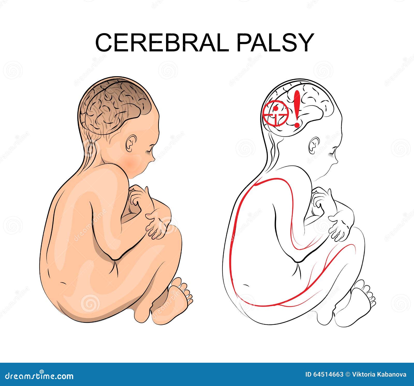Hersen Verlamming Neurologie Vector Illustratie - Illustration of ...