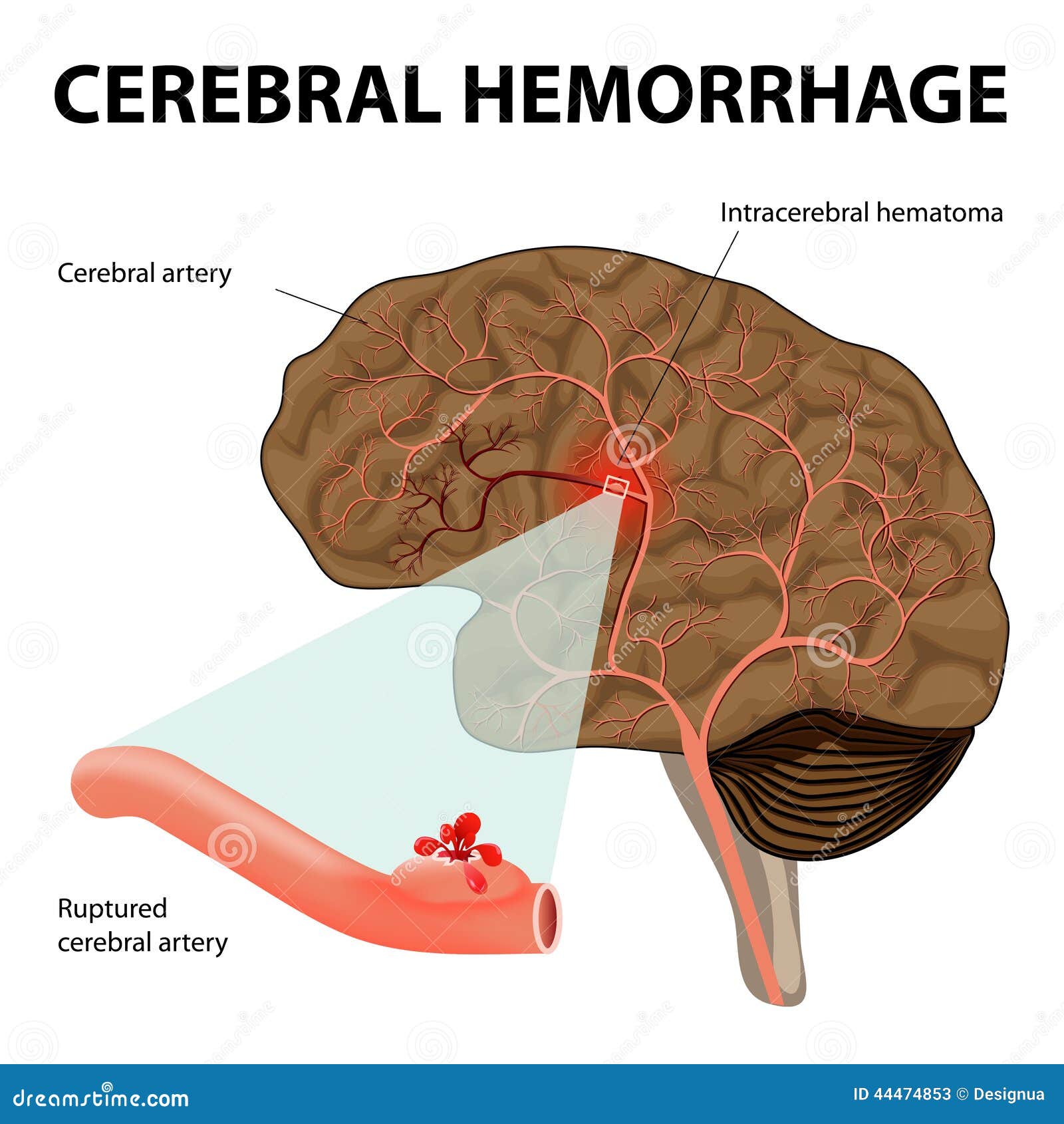 Hersenbloeding vector illustratie. Illustration of hemorragie - 44474853