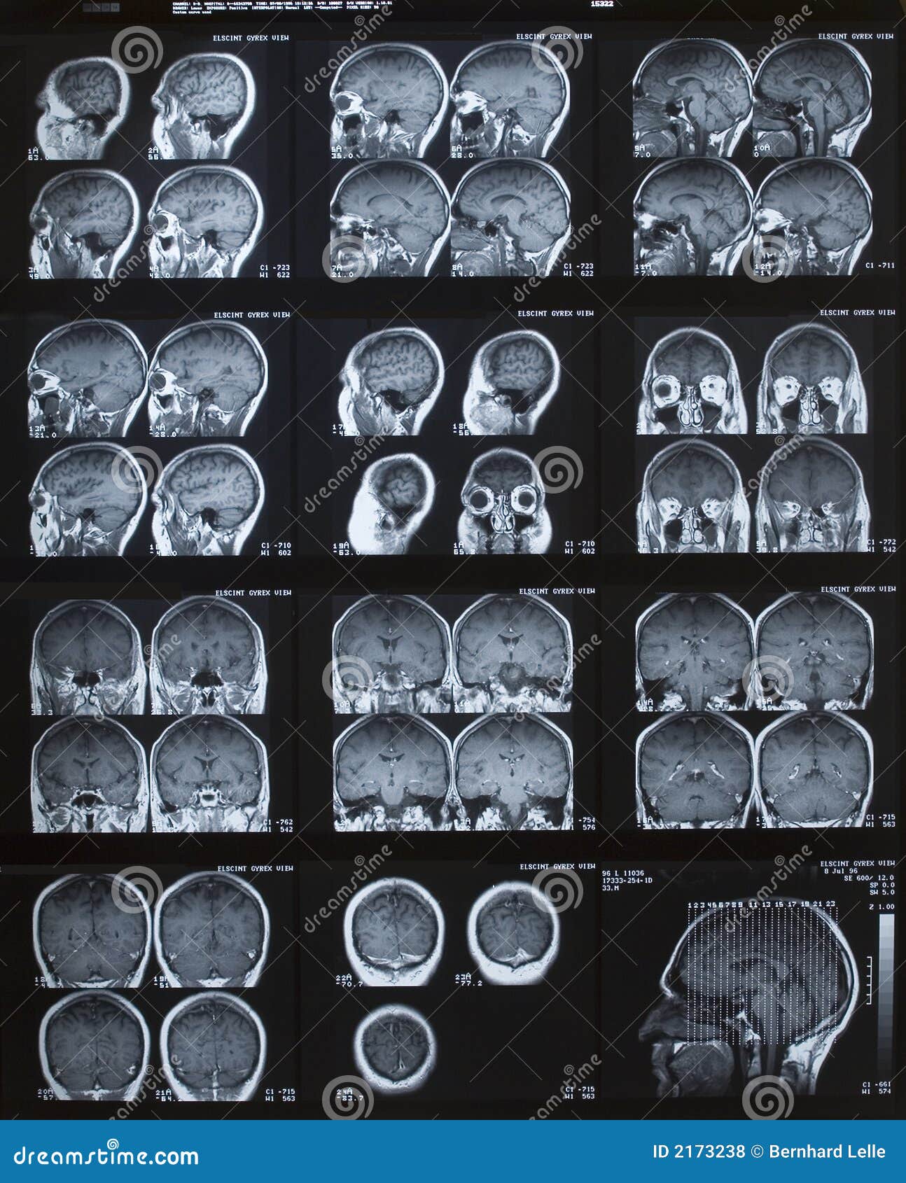 Hersenen MRI stock foto. Image of kliniek, schedel, aftasten - 2173238
