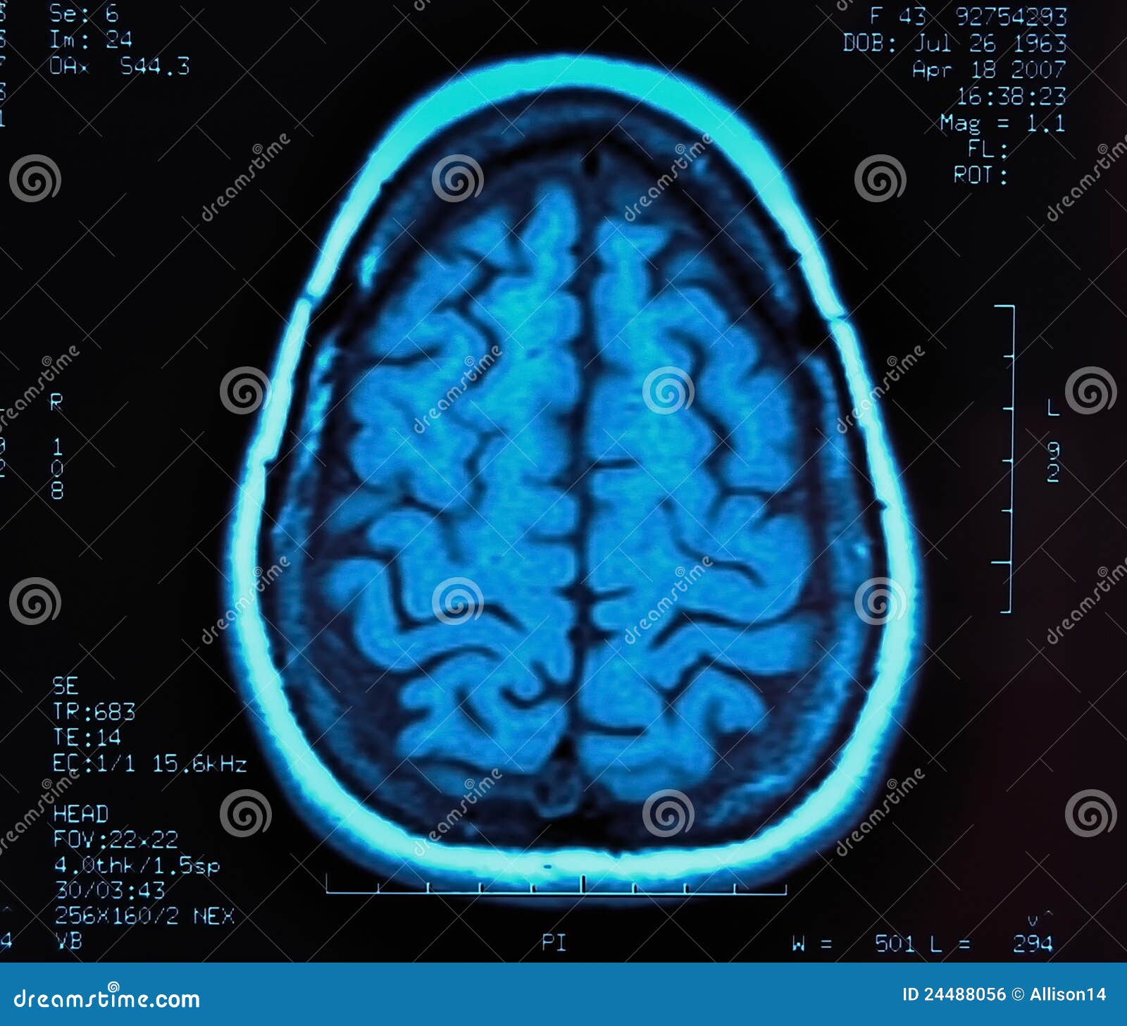 Hersenen MRI stock foto. Image of hersenen, straal, lichaam - 24488056