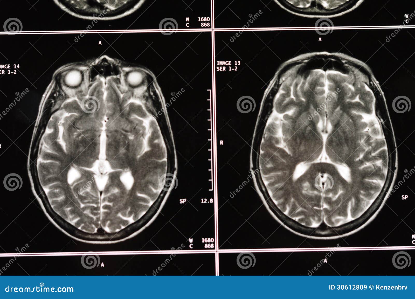 Hersenen MRI stock afbeelding. Image of kenmerkend, onderzoek - 30612809