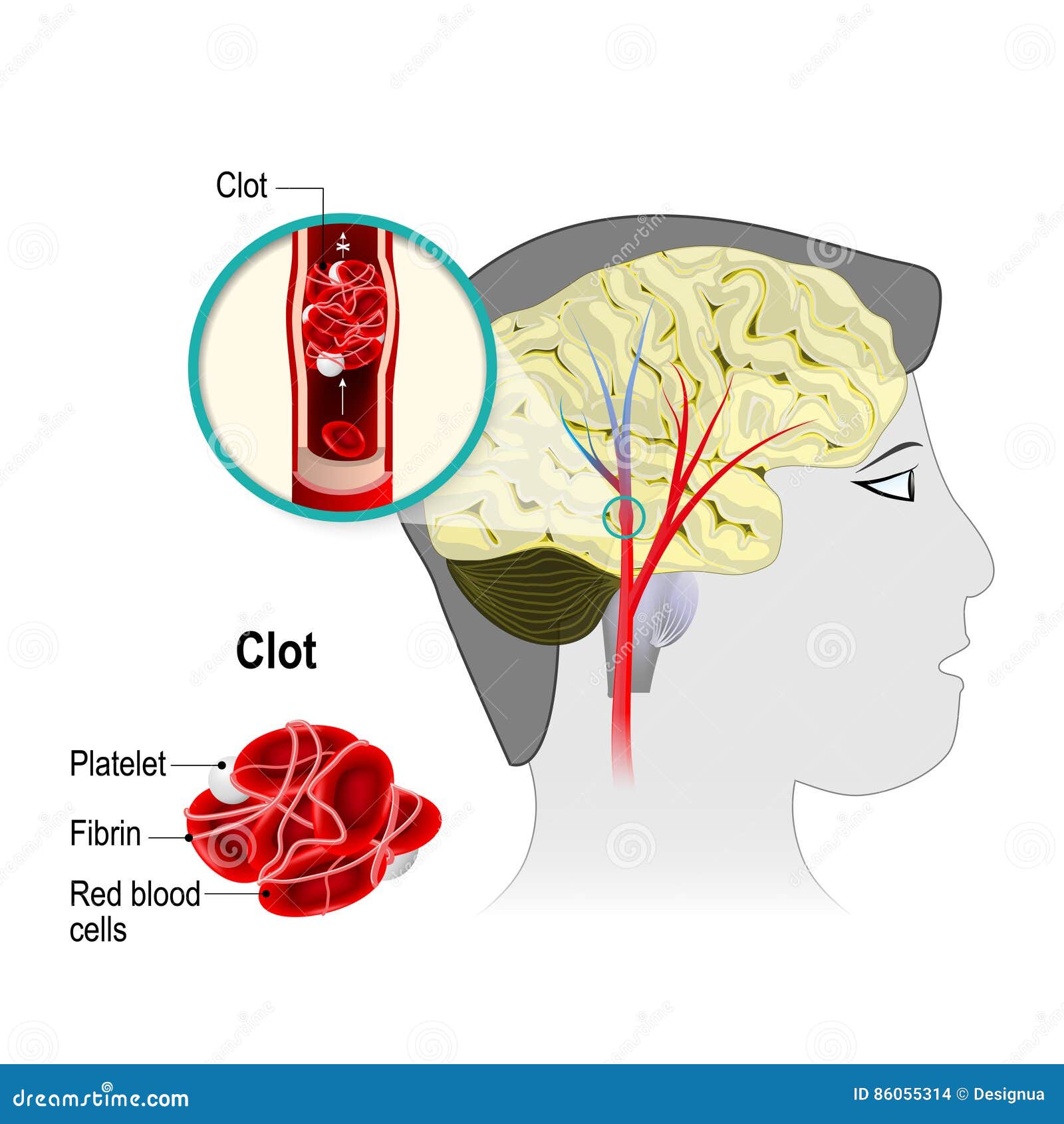 Herseninfarct vector illustratie. Illustration of atherosclerose - 86055314