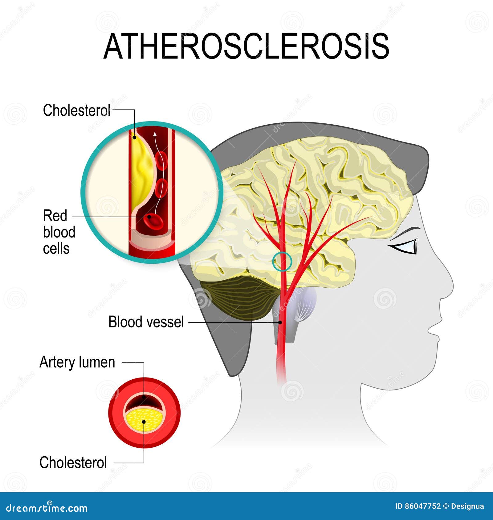 Hersenslagader Met Atherosclerose Vector Illustratie - Illustration of ...