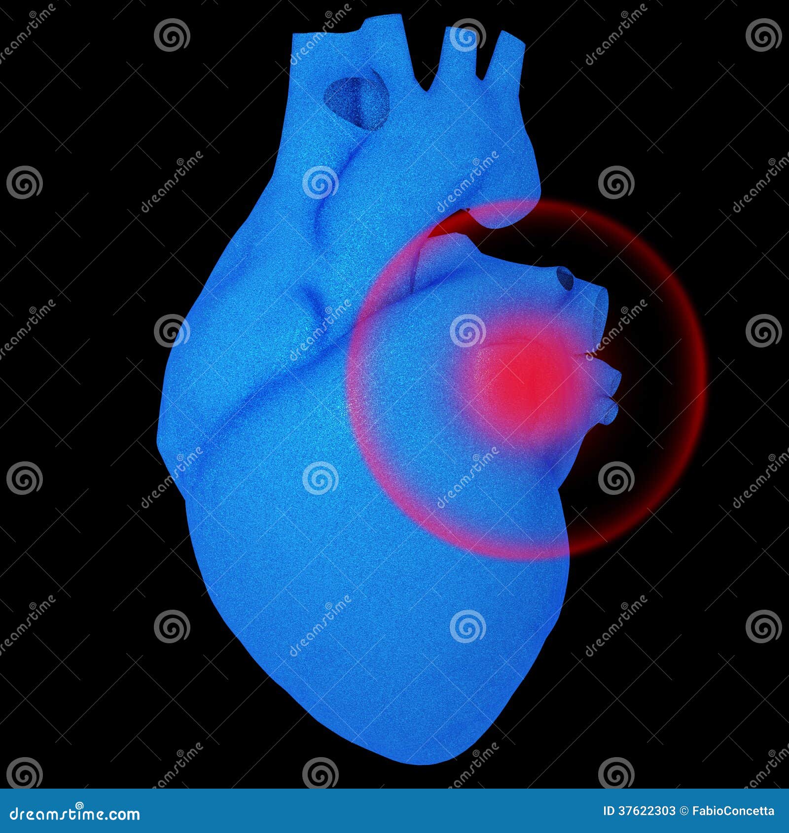 Herz Mit Den Pathologien Lokalisiert Stockbild - Bild von schmerz ...