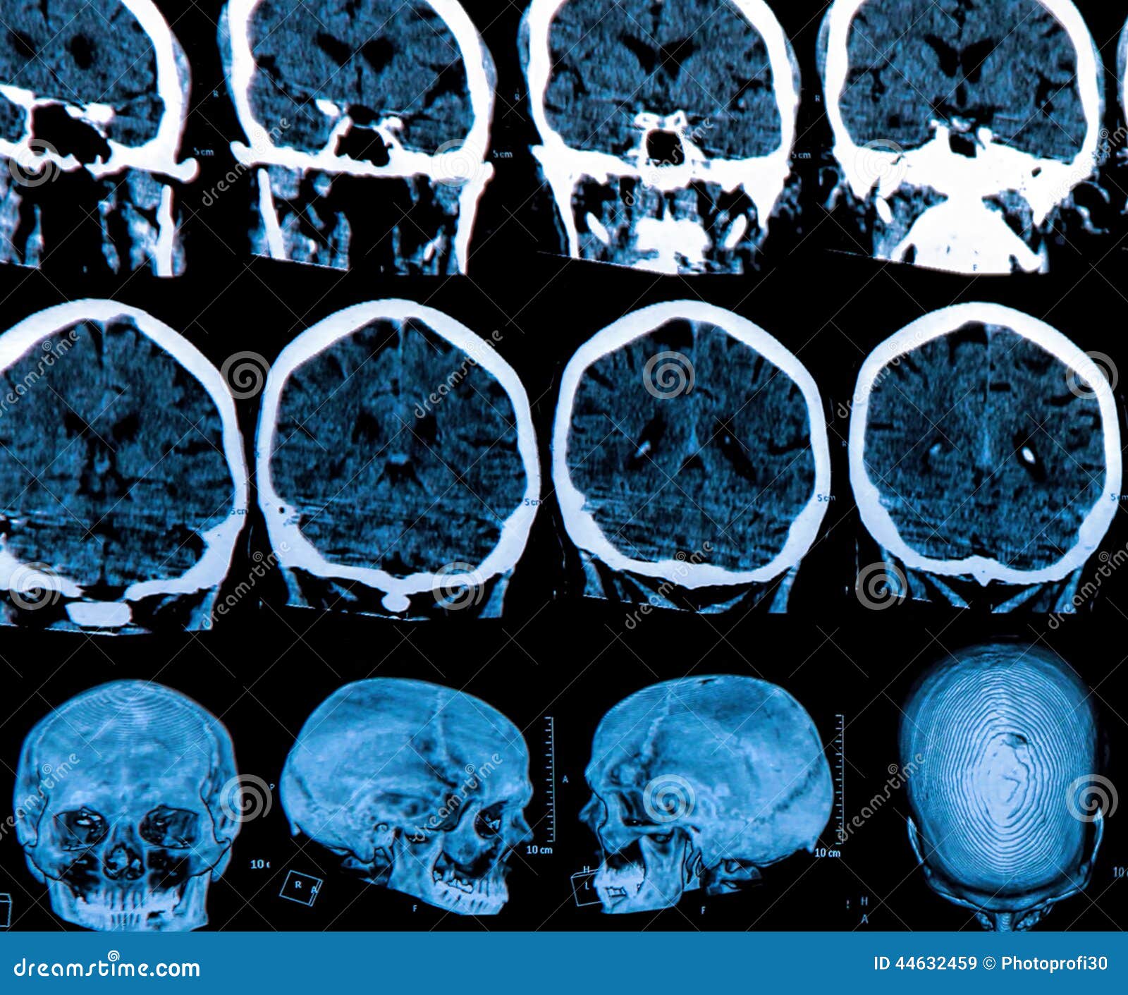 Het Aftasten Van De Hersenen Van Mri Stock Afbeelding - Image of ...