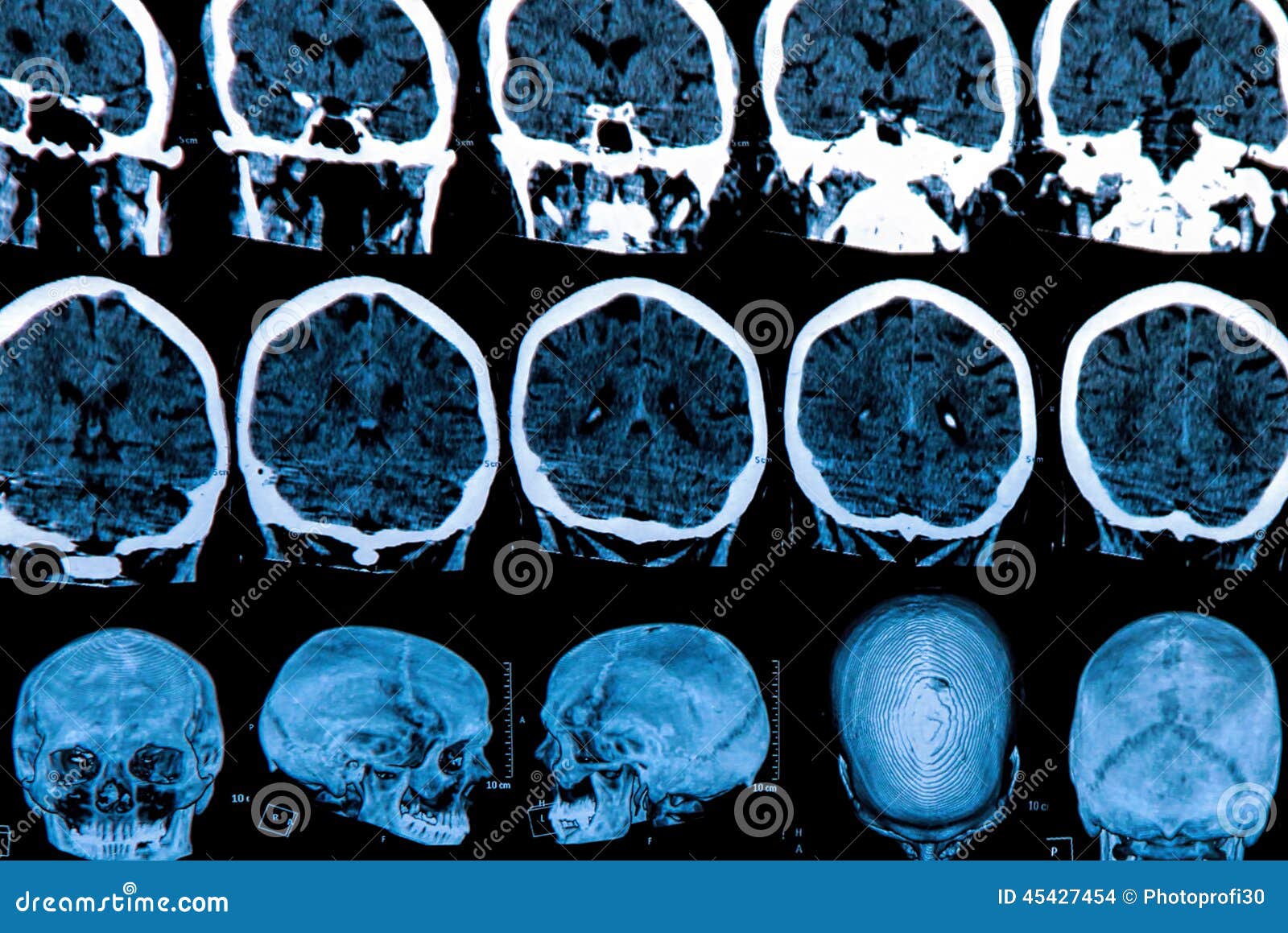 Het Aftasten Van De Hersenen Van Mri Stock Foto - Image of corpus ...