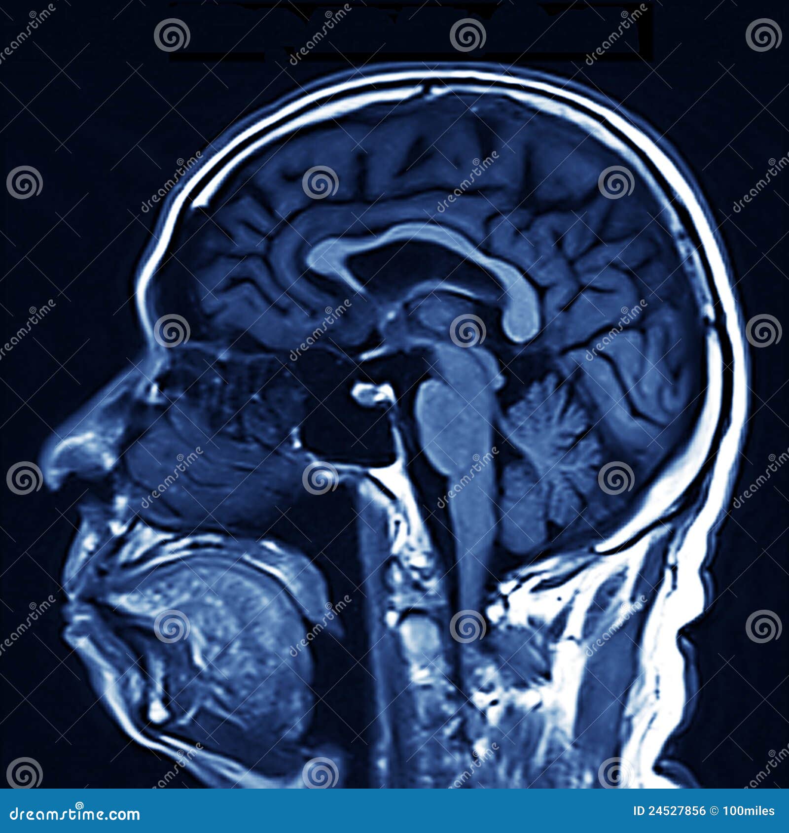 Het Aftasten Van Hersenen MRI Stock Foto - Image of controle, vormen ...
