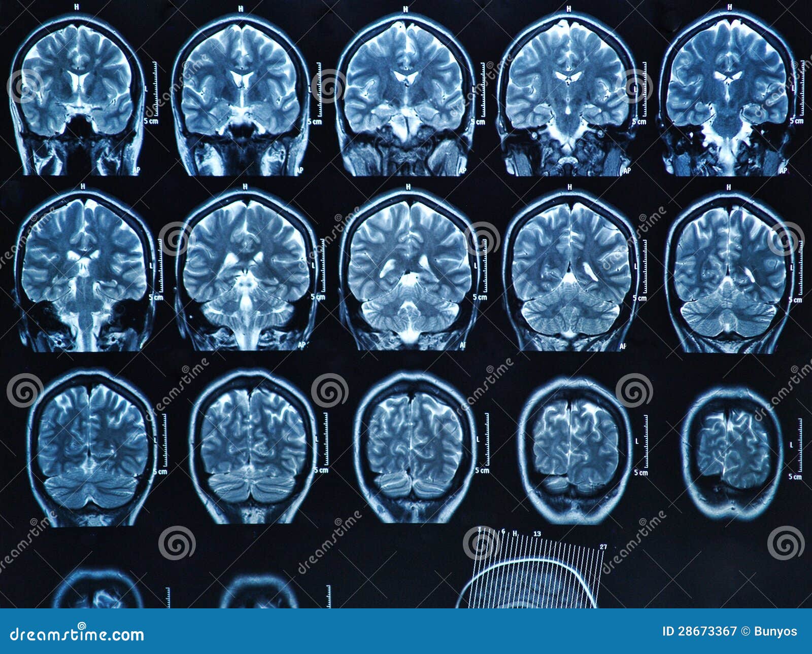 Het Aftasten Van Hersenen MRI Stock Afbeelding - Image of kwab ...