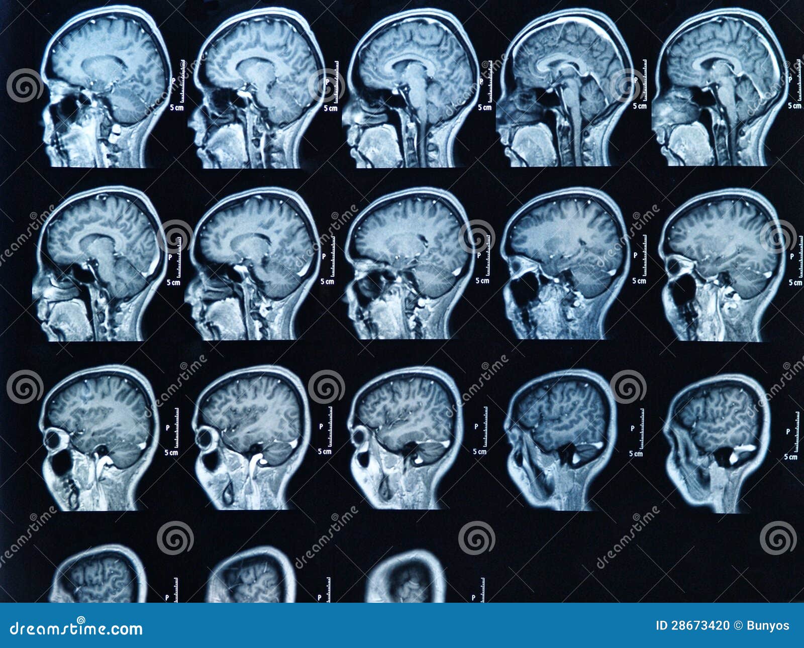 Het Aftasten Van Hersenen MRI Stock Foto - Image of geneeskunde ...
