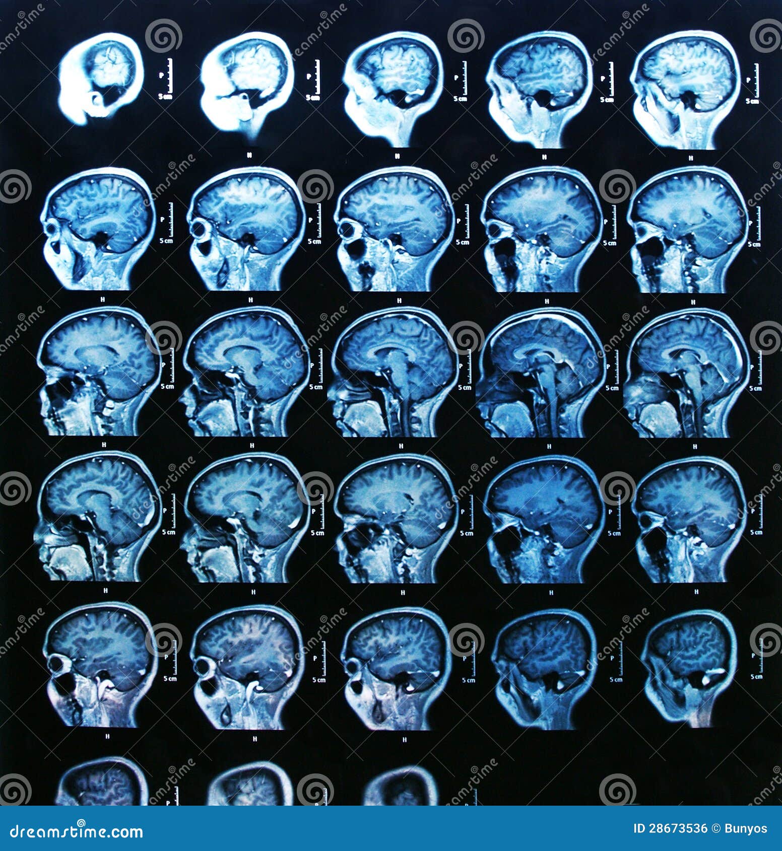 Het Aftasten Van Hersenen MRI Stock Foto - Image of hemisfeer, holte ...
