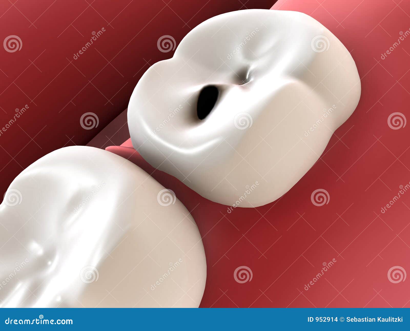 Het bederf van de tand stock illustratie. Illustration of gebit - 952914