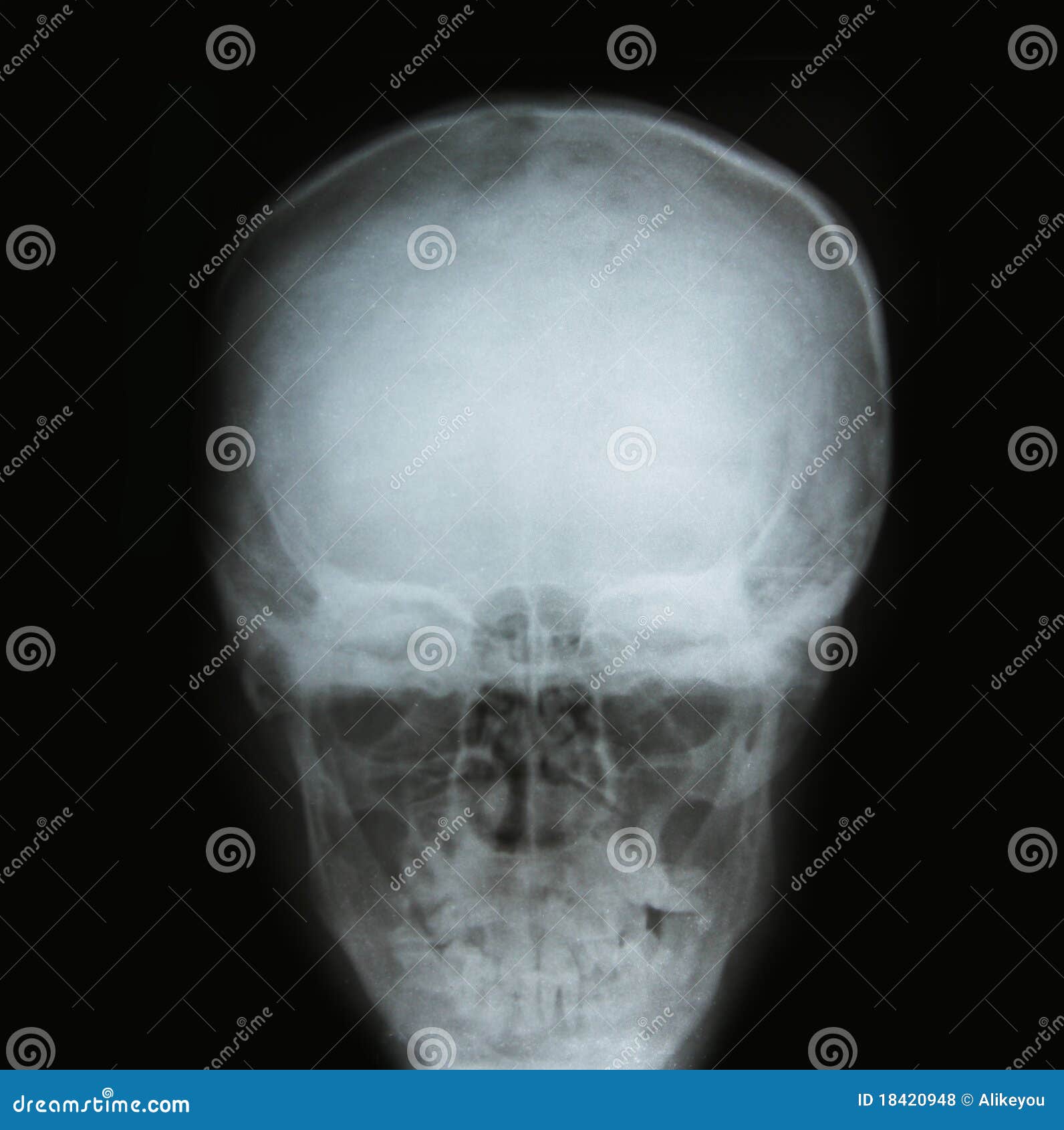 Het Beeld Van De Röntgenstraal Van De Schedel Stock Foto - Image of ...