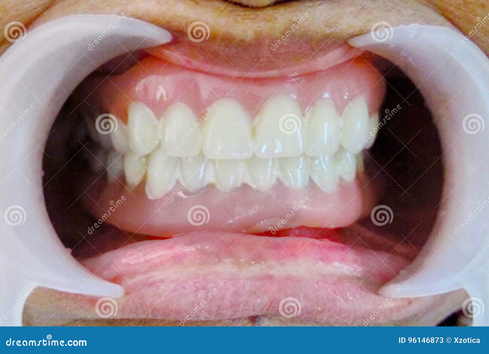 Het gebit stock afbeelding. Image of pathologie, gezond - 96146873