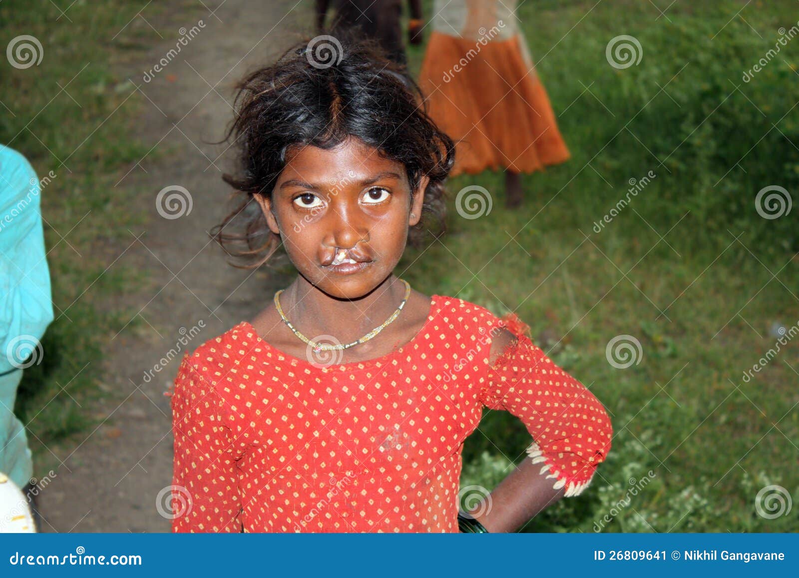 Het Gespleten En Gehemelte Van De Lip Redactionele Foto - Image of ...