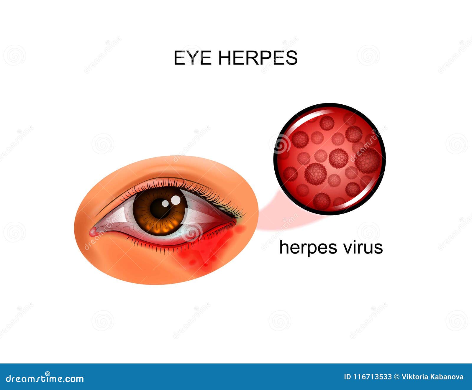 Het Herpesvirus Van Het Oog Vector Illustratie - Illustration of ...