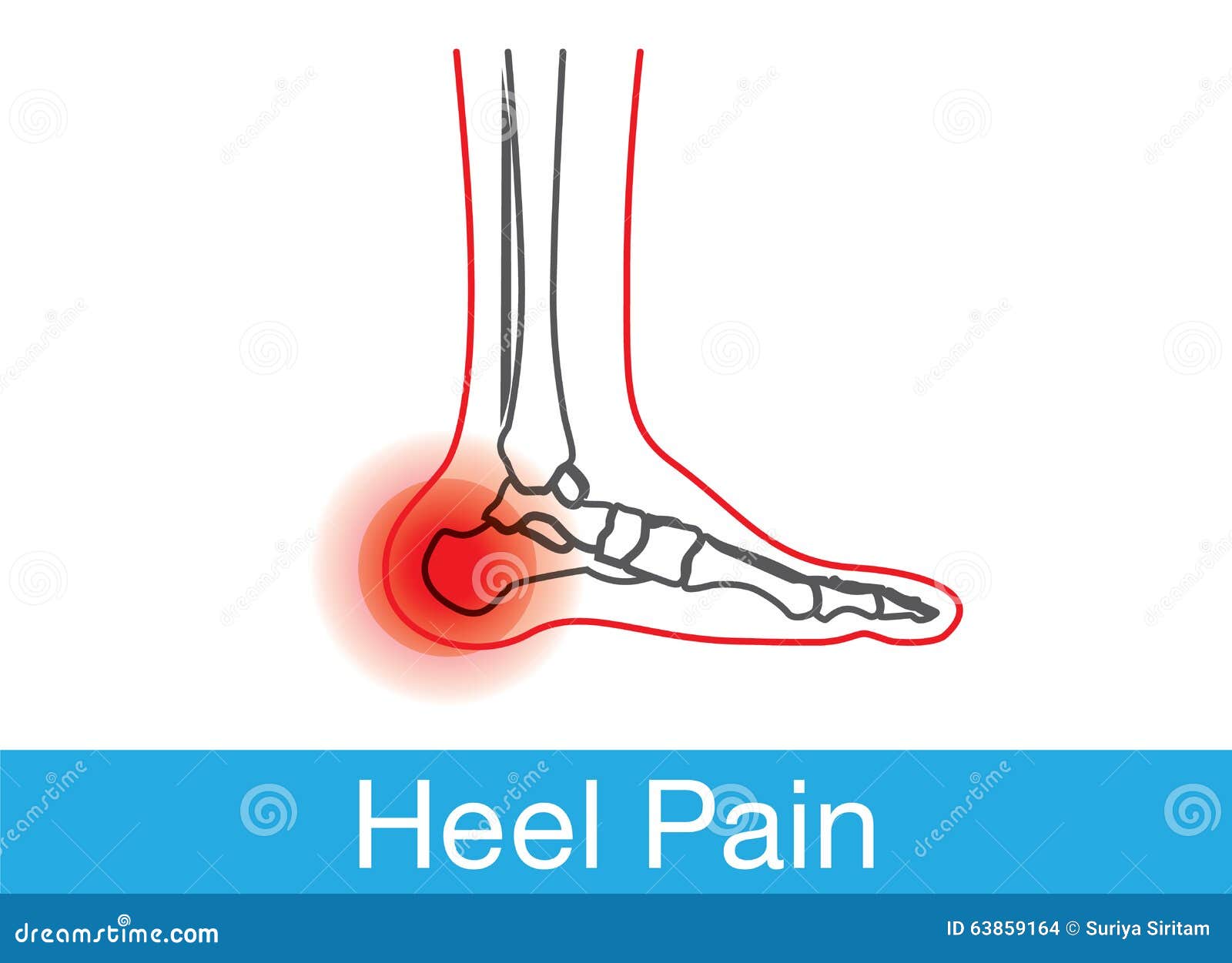 Het Overzicht Van De Hielpijn Vector Illustratie - Illustration of zorg ...