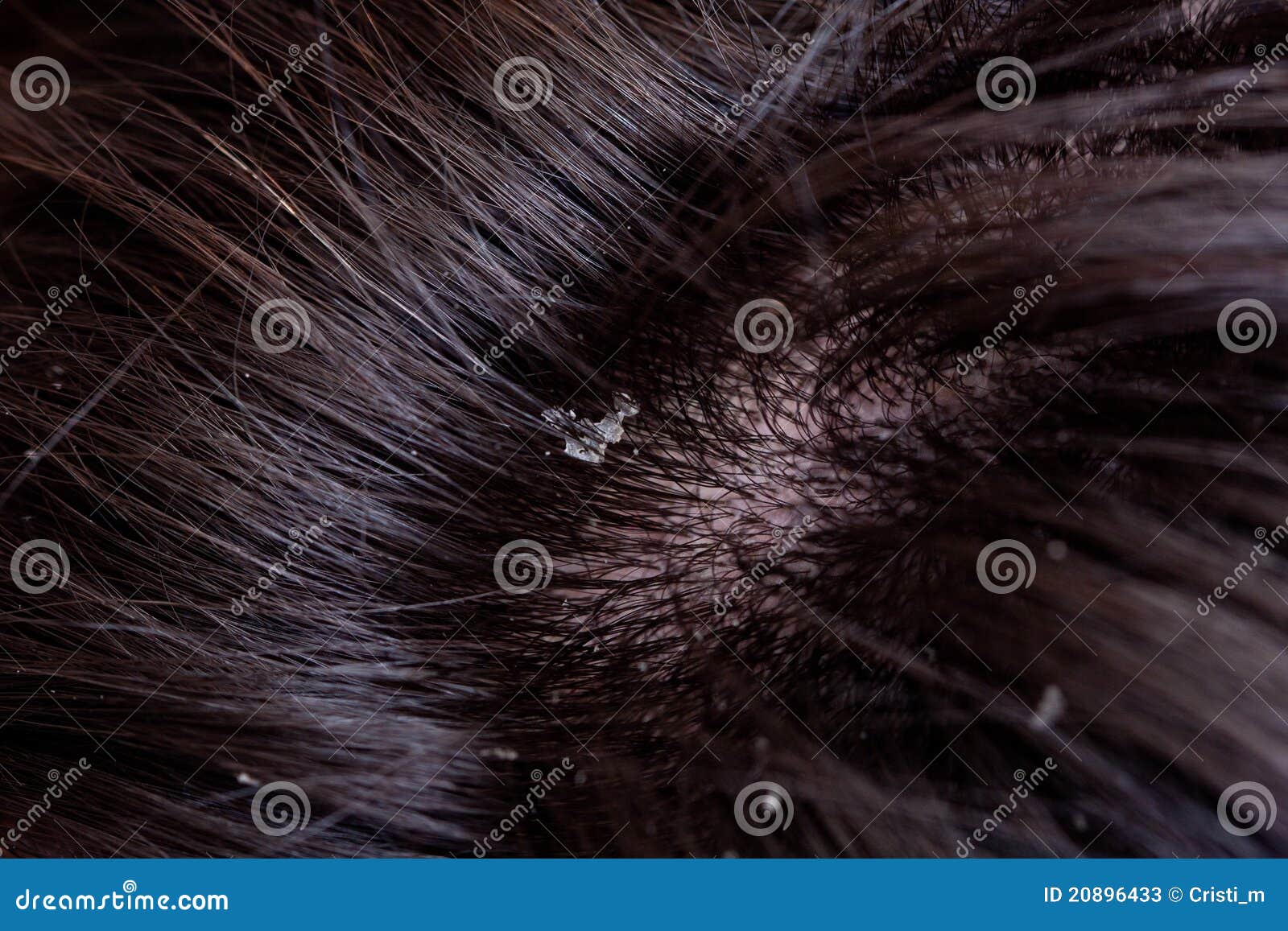 Het Probleem Van De Hoofdroos Stock Afbeelding - Image of menselijk ...