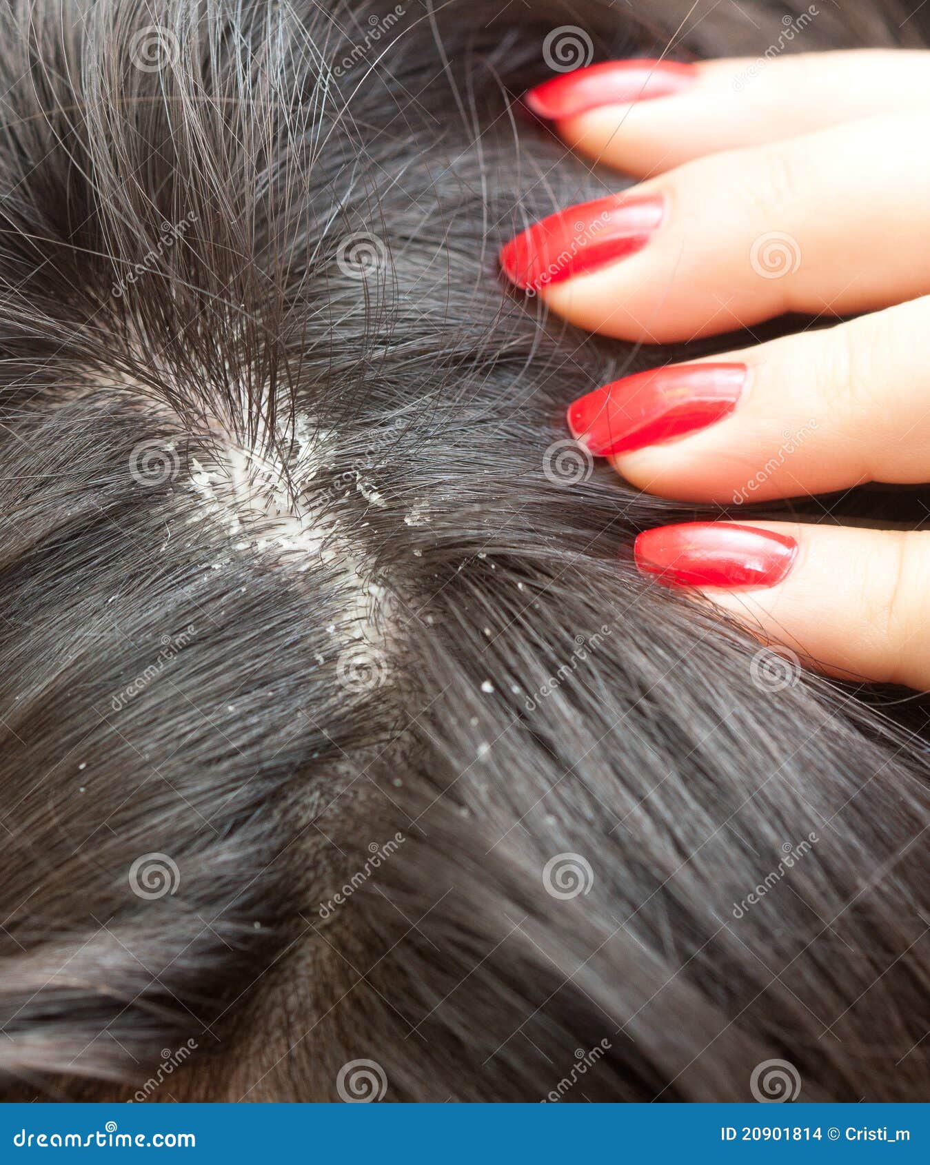 Het Probleem Van De Hoofdroos Stock Foto - Image of roes, medisch: 20901814