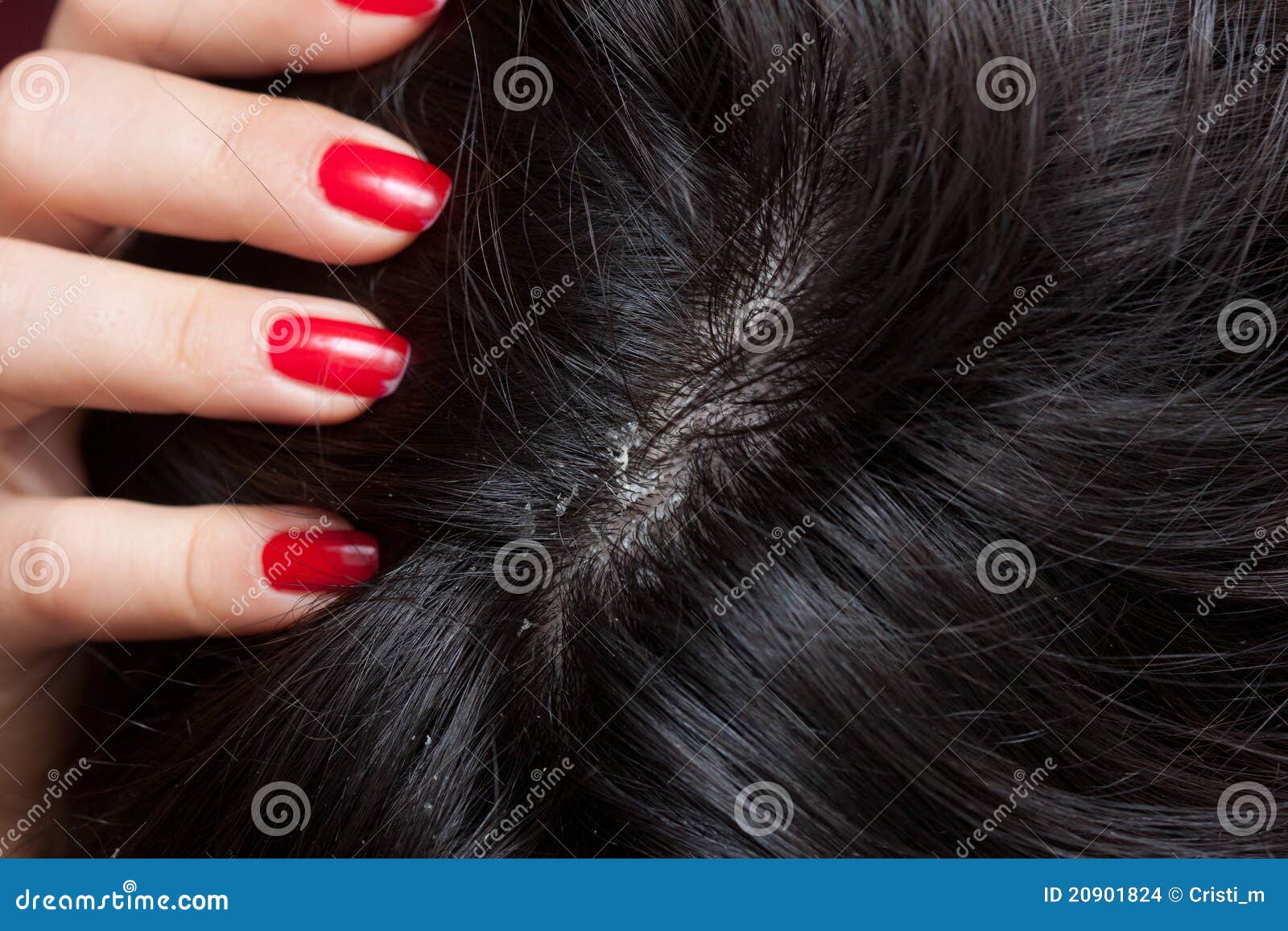 Het Probleem Van De Hoofdroos Stock Foto - Image of schap, medicijn ...