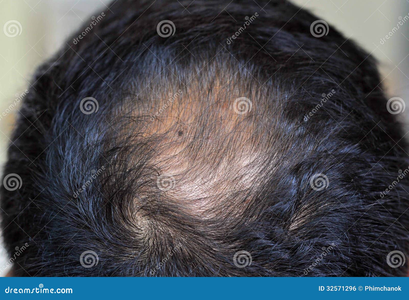 Het Probleem Van Het Haarverlies Stock Foto - Image of kaplijn ...