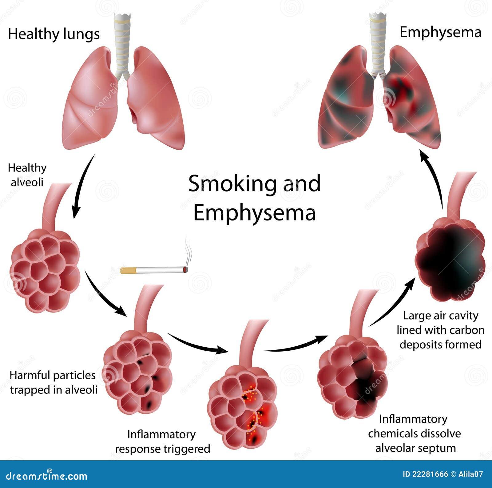 Het roken en Emfyseem vector illustratie. Illustration of membraan ...