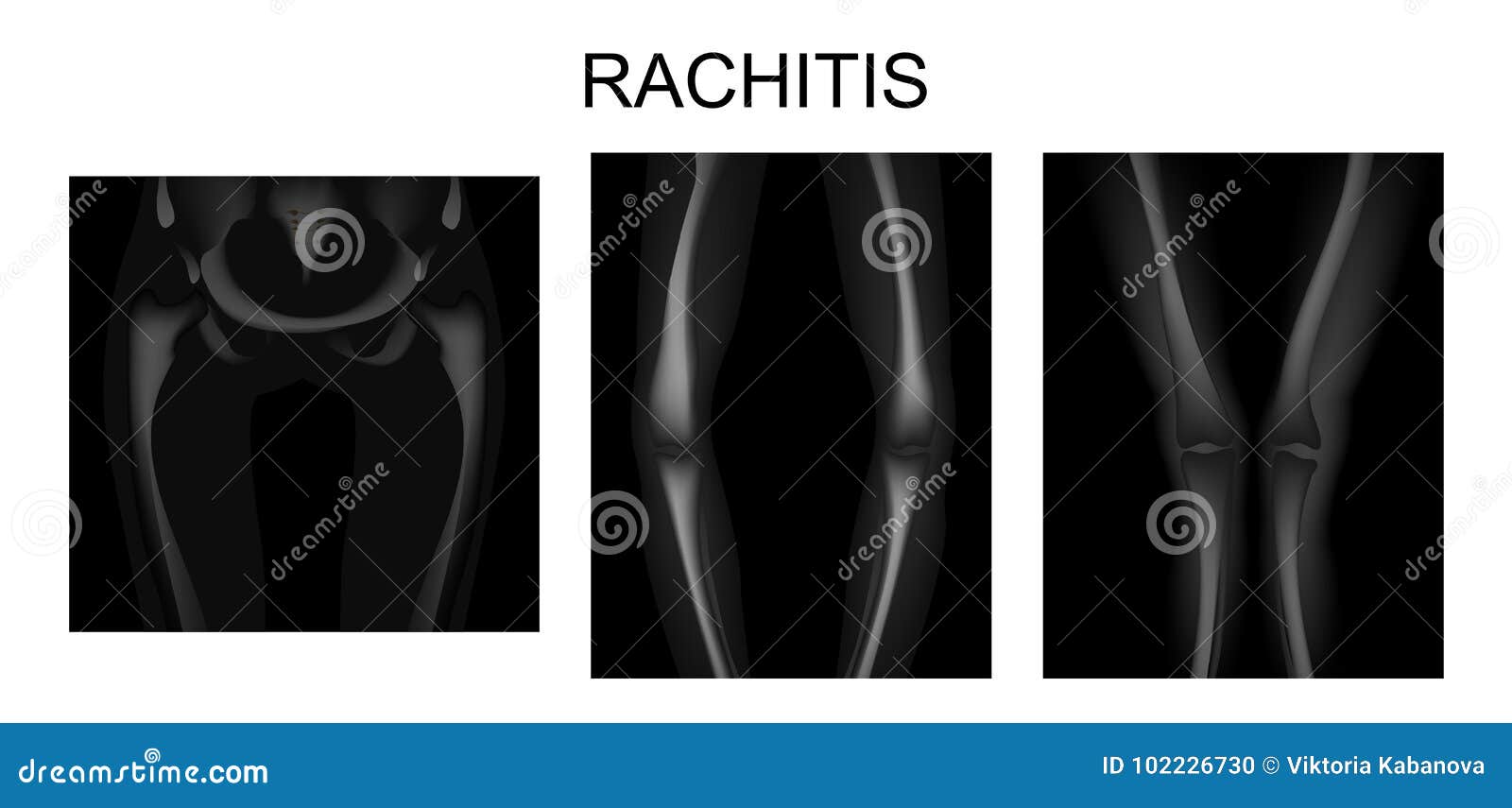 Het Skelet Van De Lagere Lidmaten in Rachitis Vector Illustratie ...