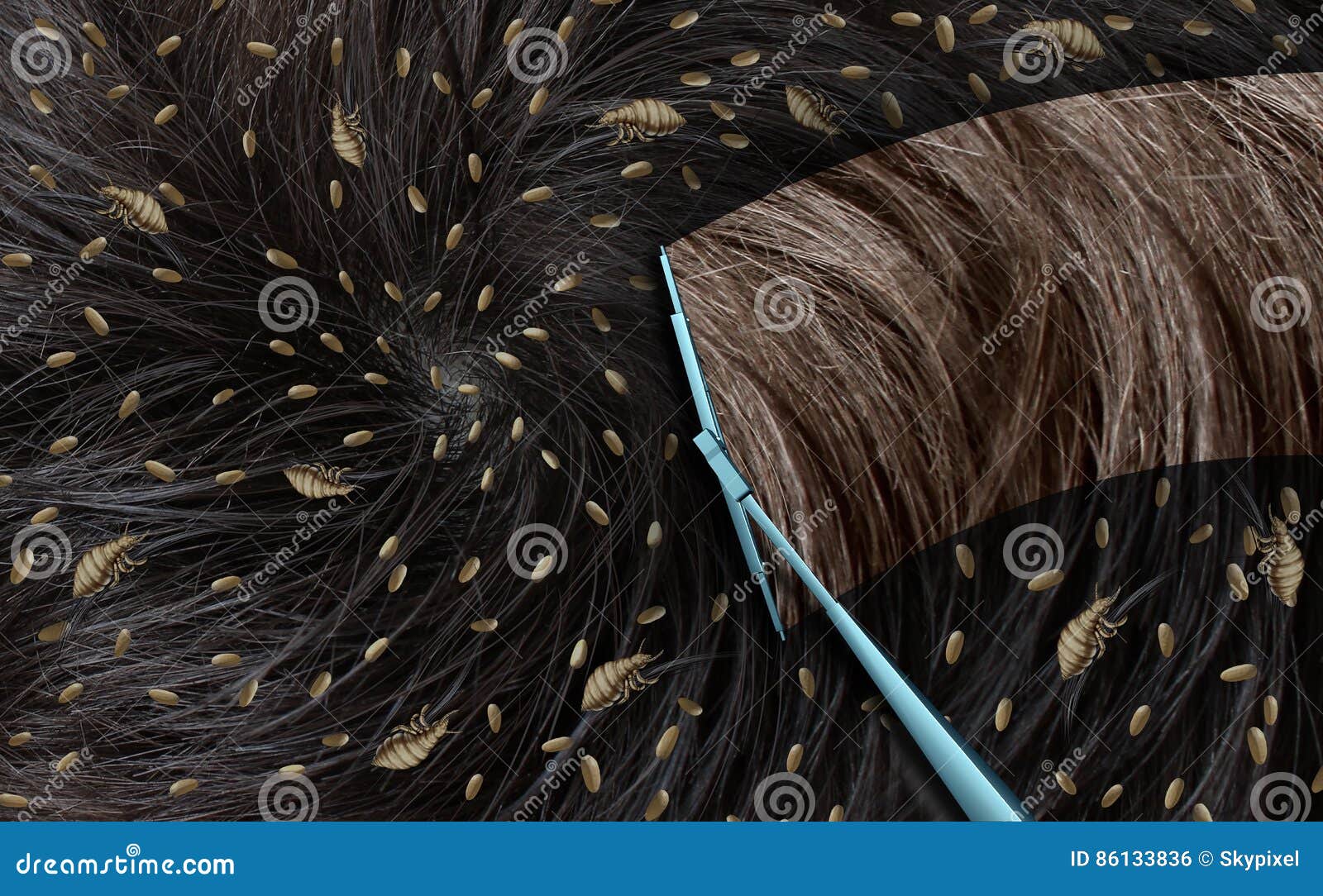 Het verwijderen van Luizen stock illustratie. Illustration of insecten ...