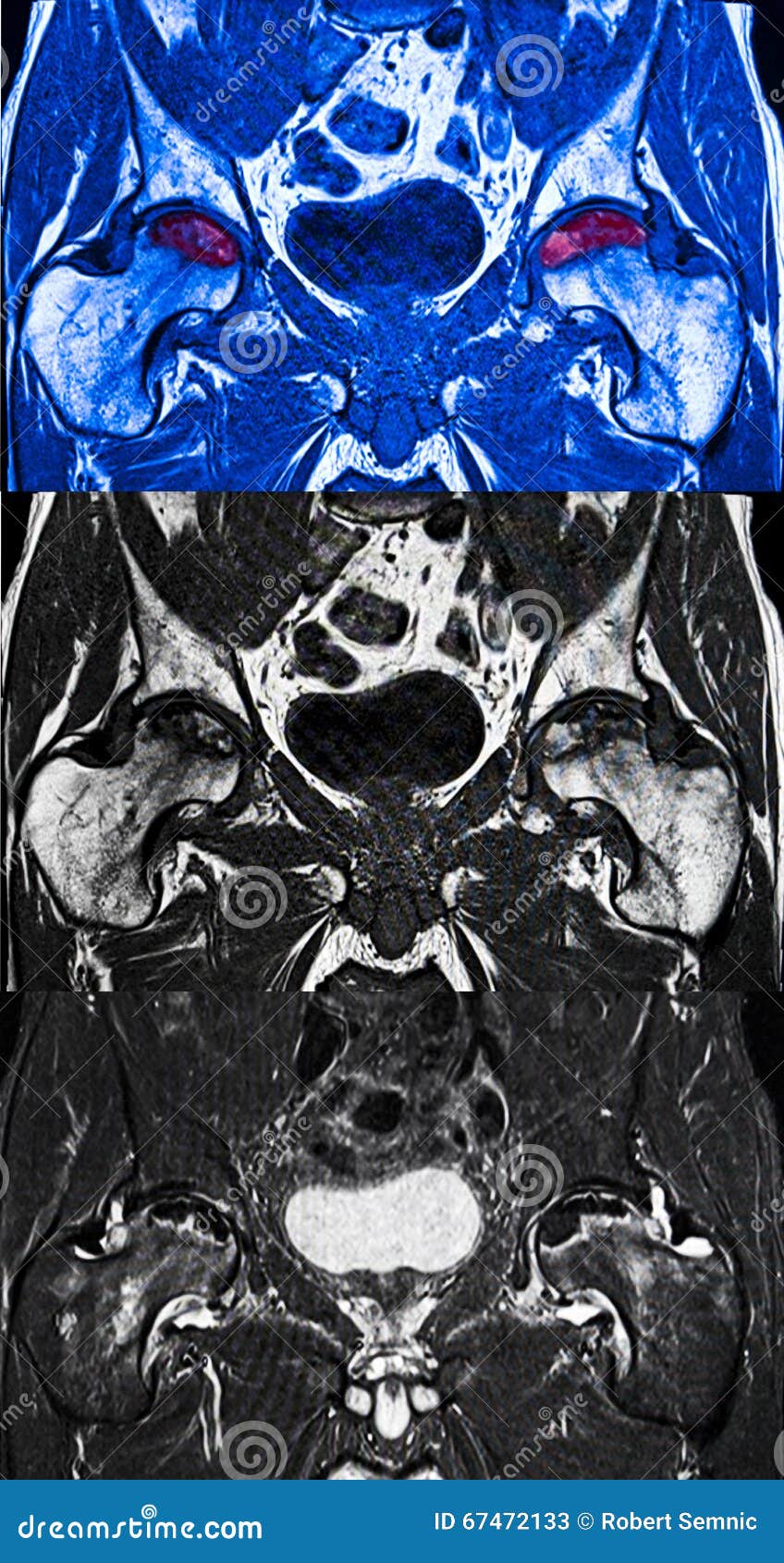 Heup Avascular Necrose, MRI Stock Afbeelding - Image of gebied, zorg ...