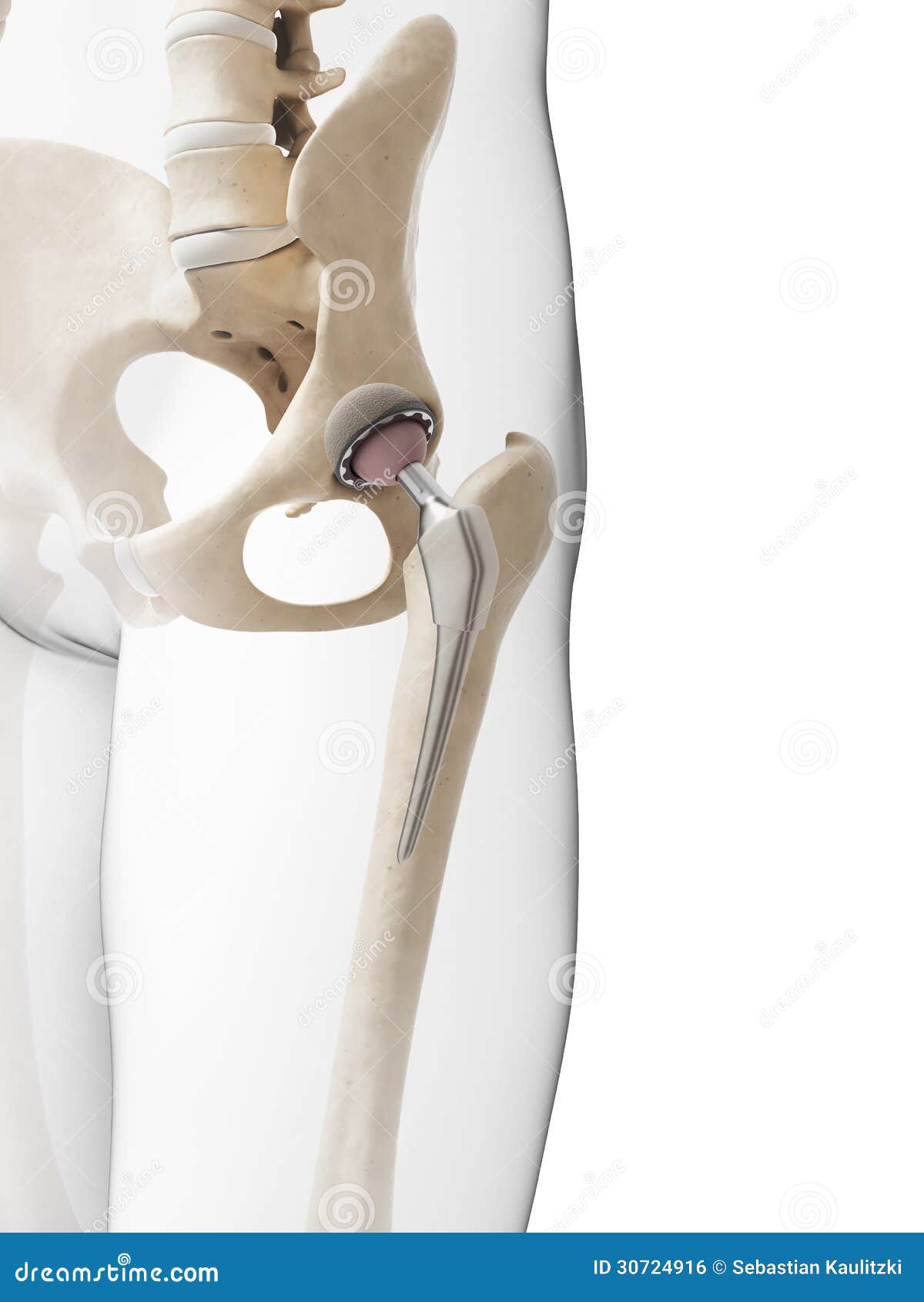 Heupvervanging stock illustratie. Illustration of ziekte - 30724916