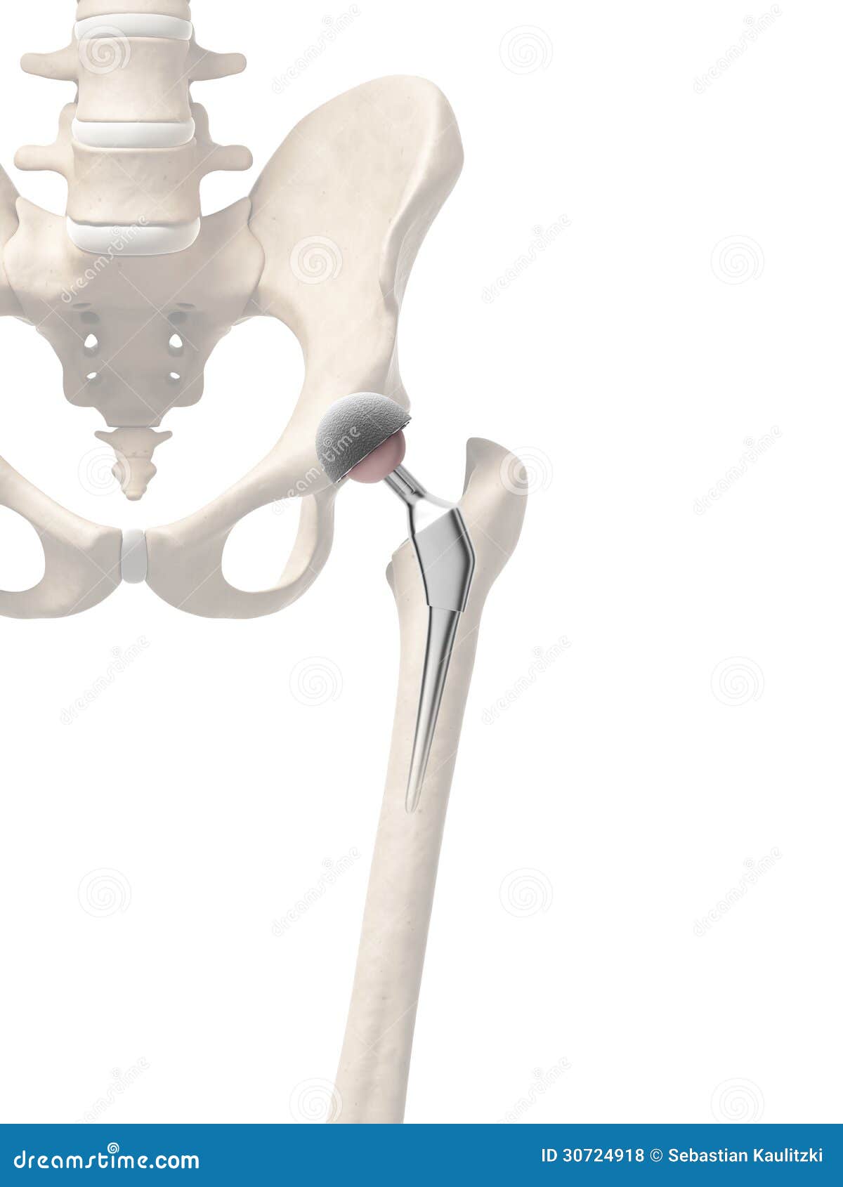Heupvervanging stock illustratie. Illustration of illustratie - 30724918