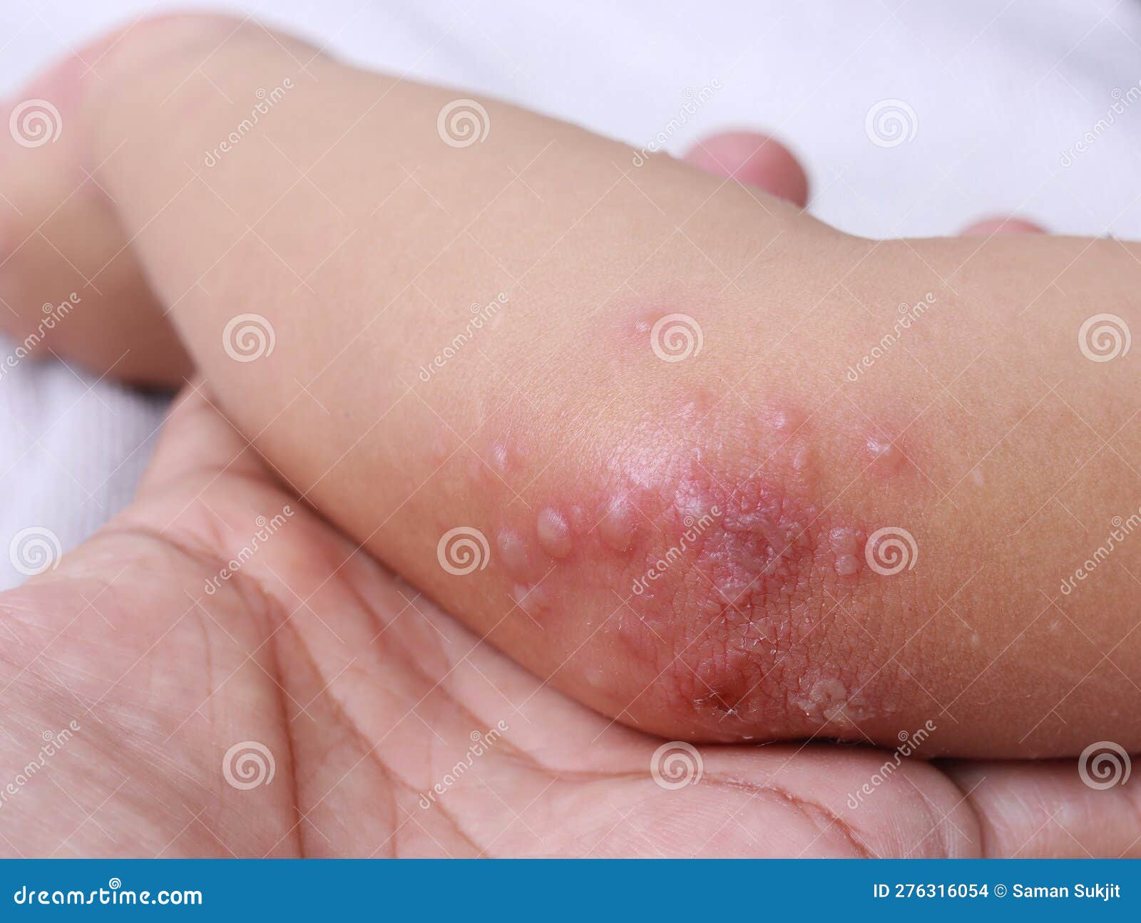 Hfmd Hand Foot And Mouth Disease Viral Diseases Stock Image 84113701