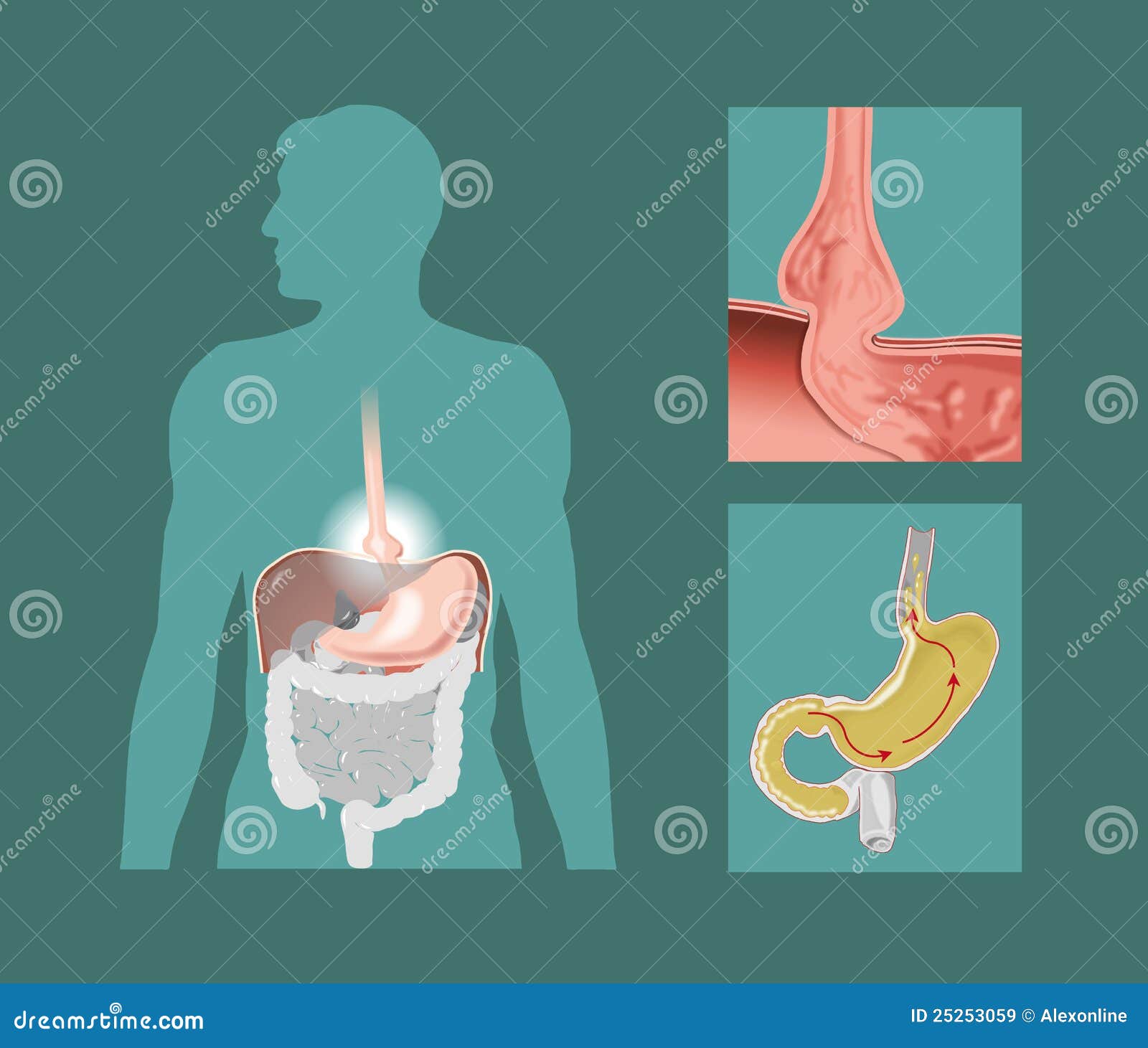 Hernia Cartoons Illustrations And Vector Stock Images 448 Pictures To